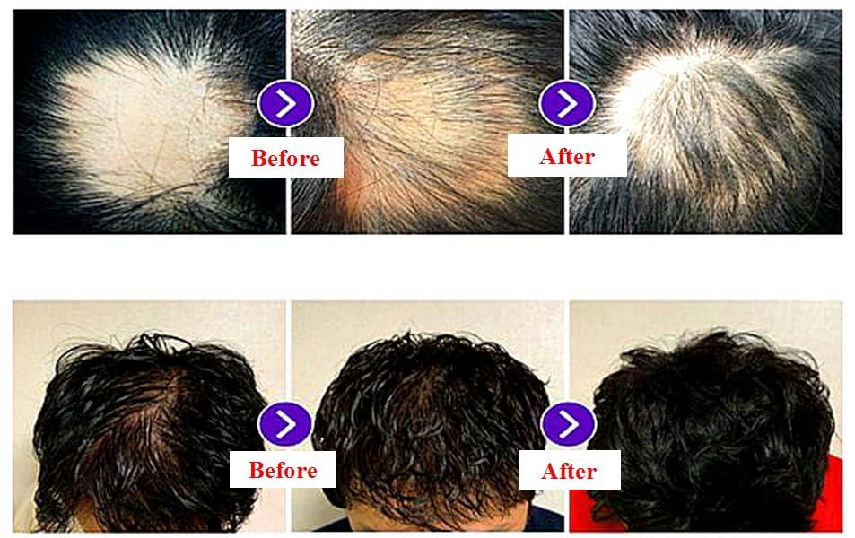 WHITESILK Fortifying Scalp Serum - SCM & Nano 9-Exosome Technology for ...