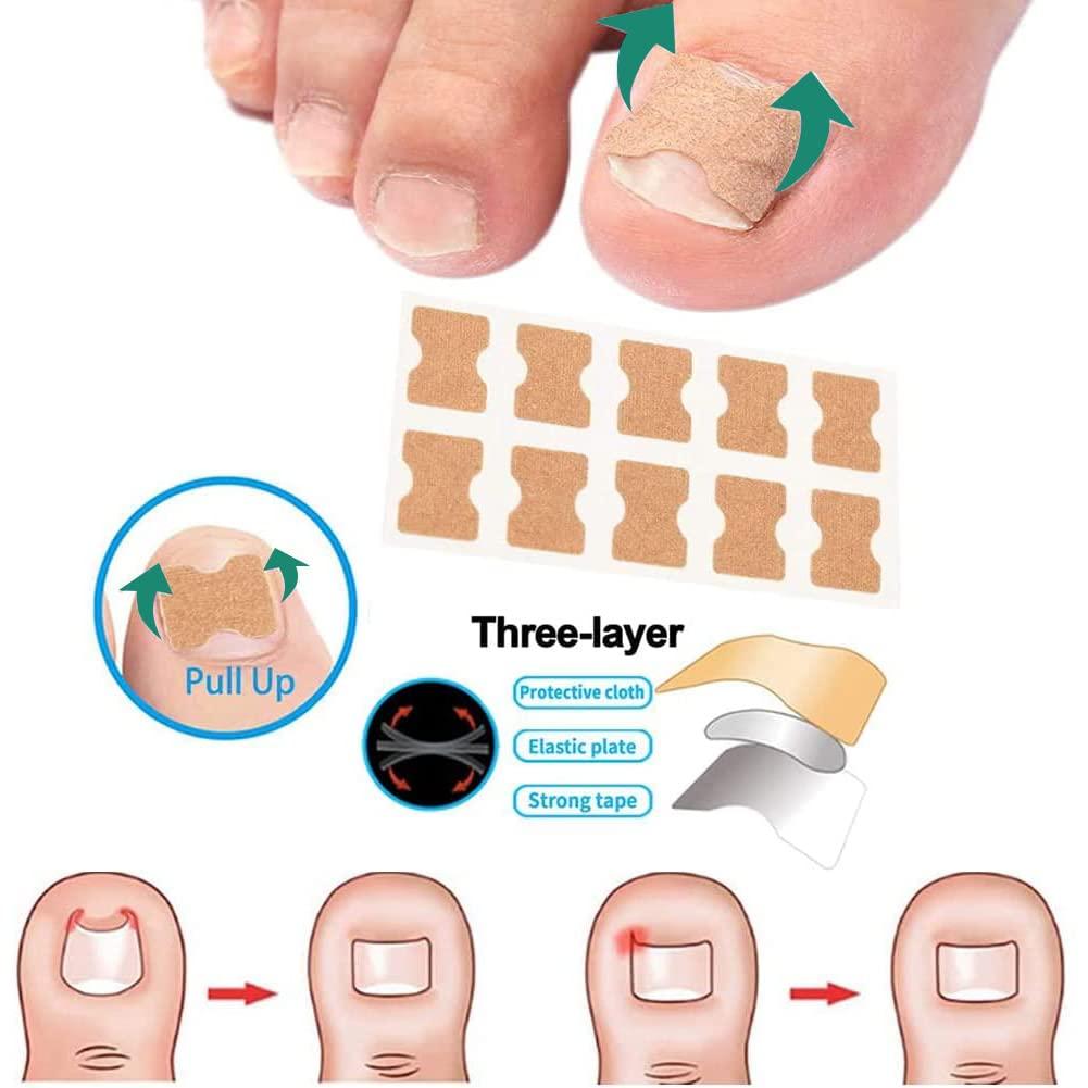 Ingrown Toenail Correction Stickers Kit - Pain-Free Toenail Corrector ...