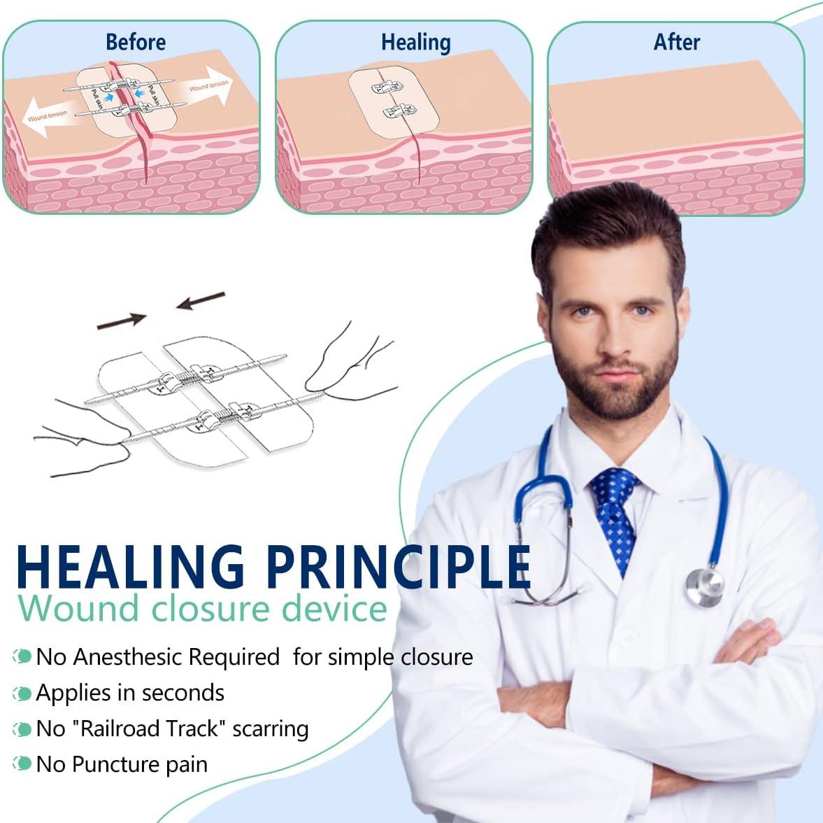 ArixMed Emergency Wound Closure Device - Zip Sutures Butterfly Bandaids ...