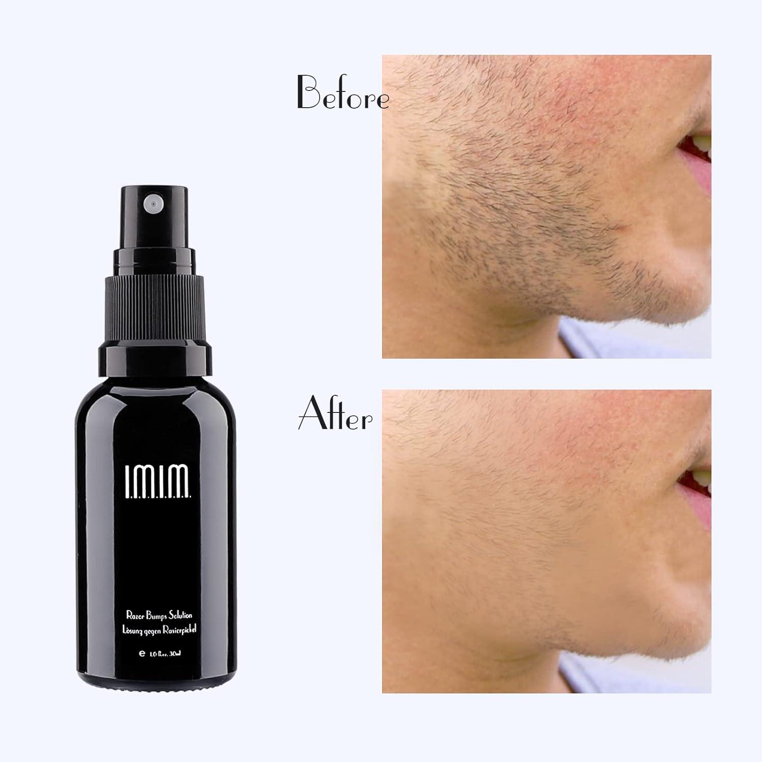 IMIM Razor Bumps Solution | For Ingrown Hair & Razor Burns | 30ml ...