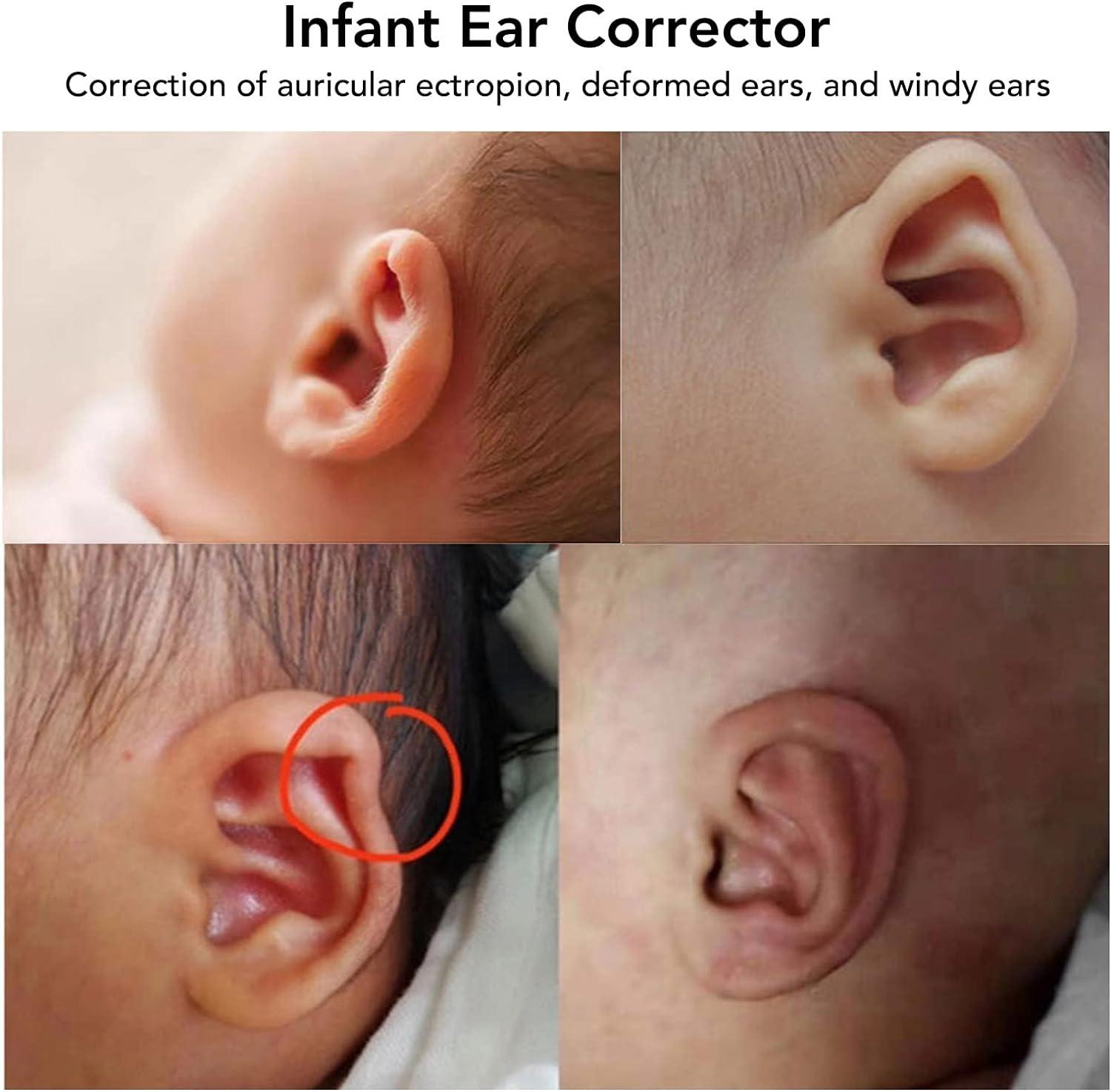 TOPINCN 3 PCS Silicone Newborn Baby Ear Correctors for Ectropion ...