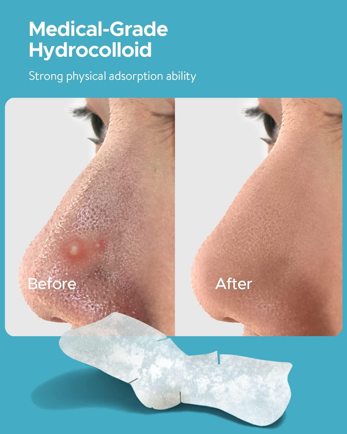 LitBear XL T-Zone Patch - 30 Patches, Hydrocolloid for Nose, Forehead ...