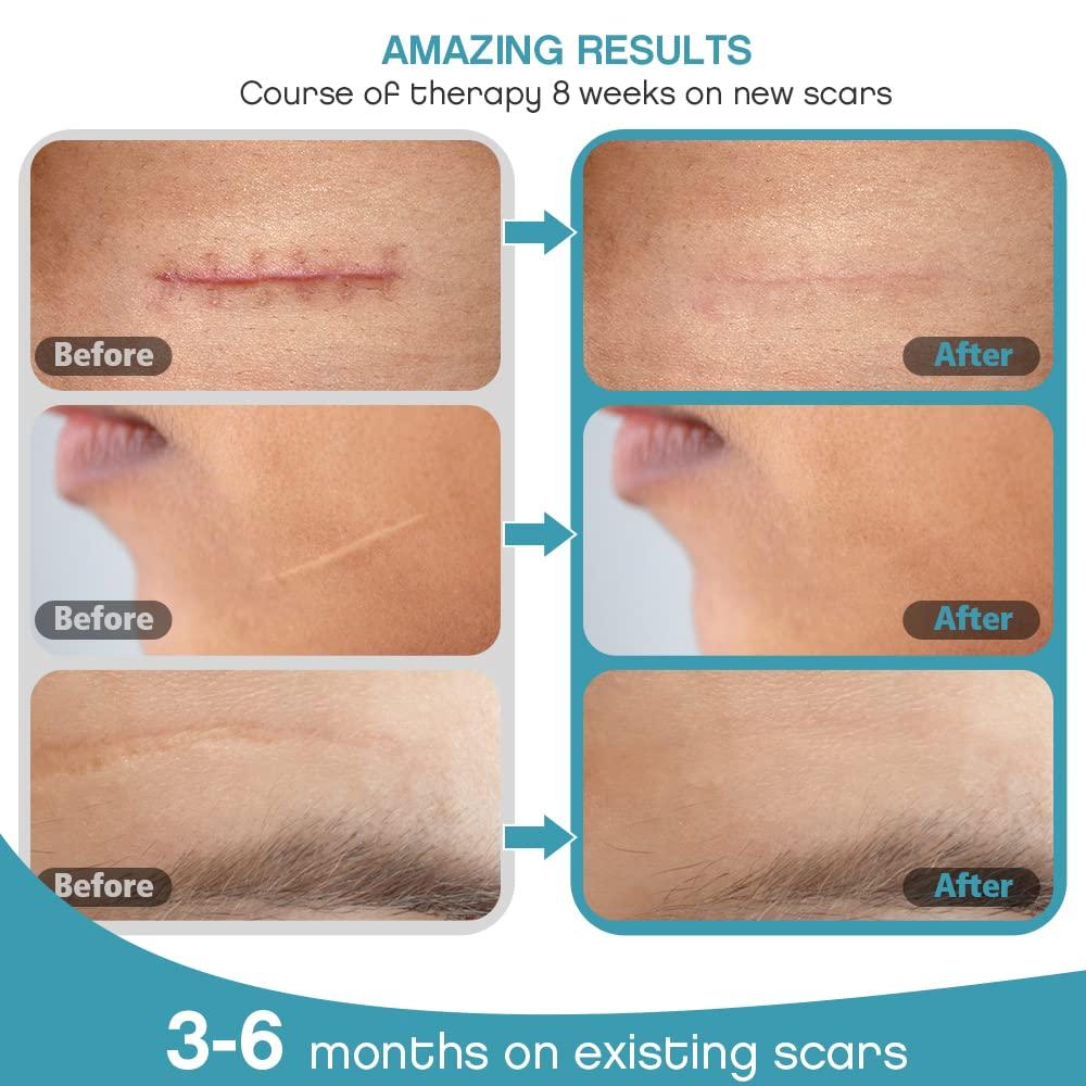 Silicone Scar Strips 1.6''x6'' - 4 pcs Multi-Use Scar Removal Cream (2 ...