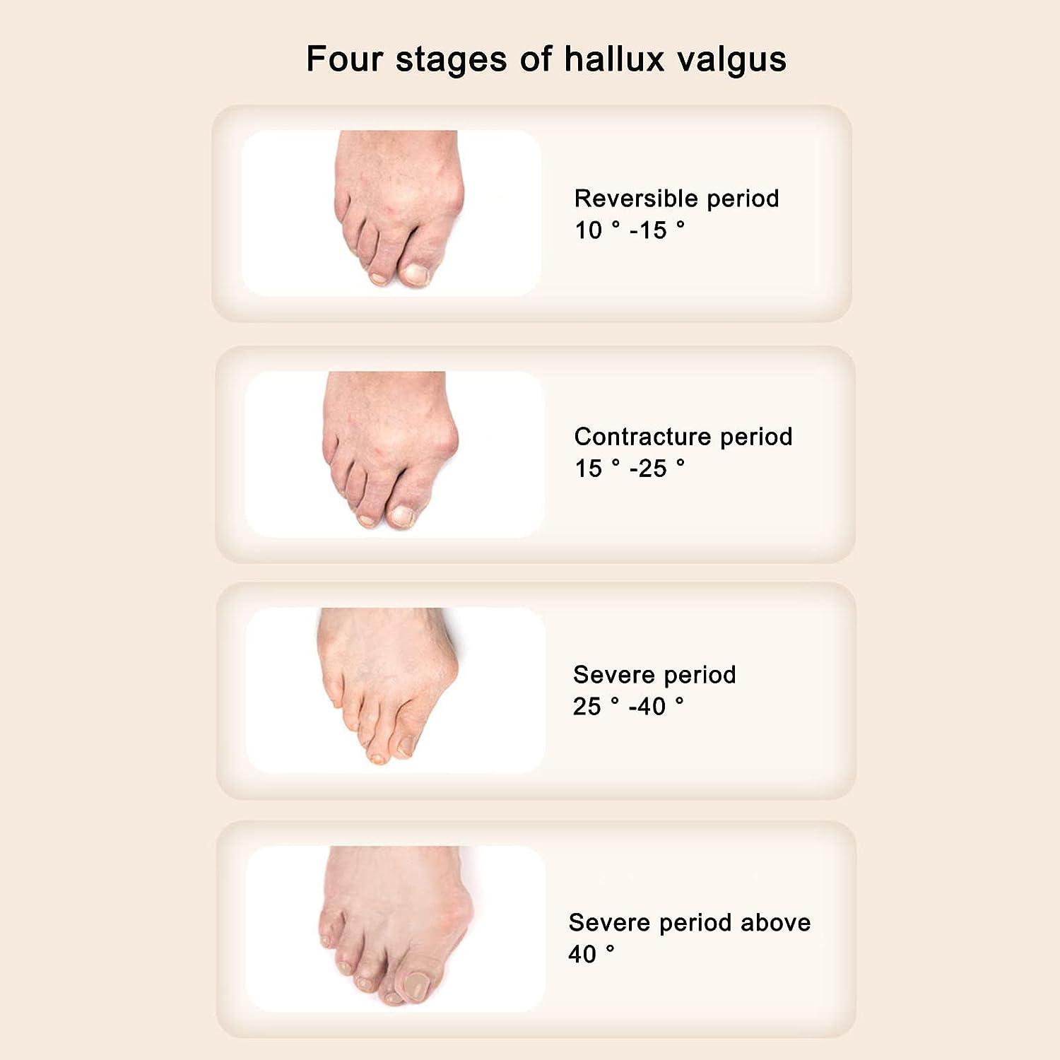 Hallux Valgus Corrector with Adjustable Bunion Splint - Ergonomic ...