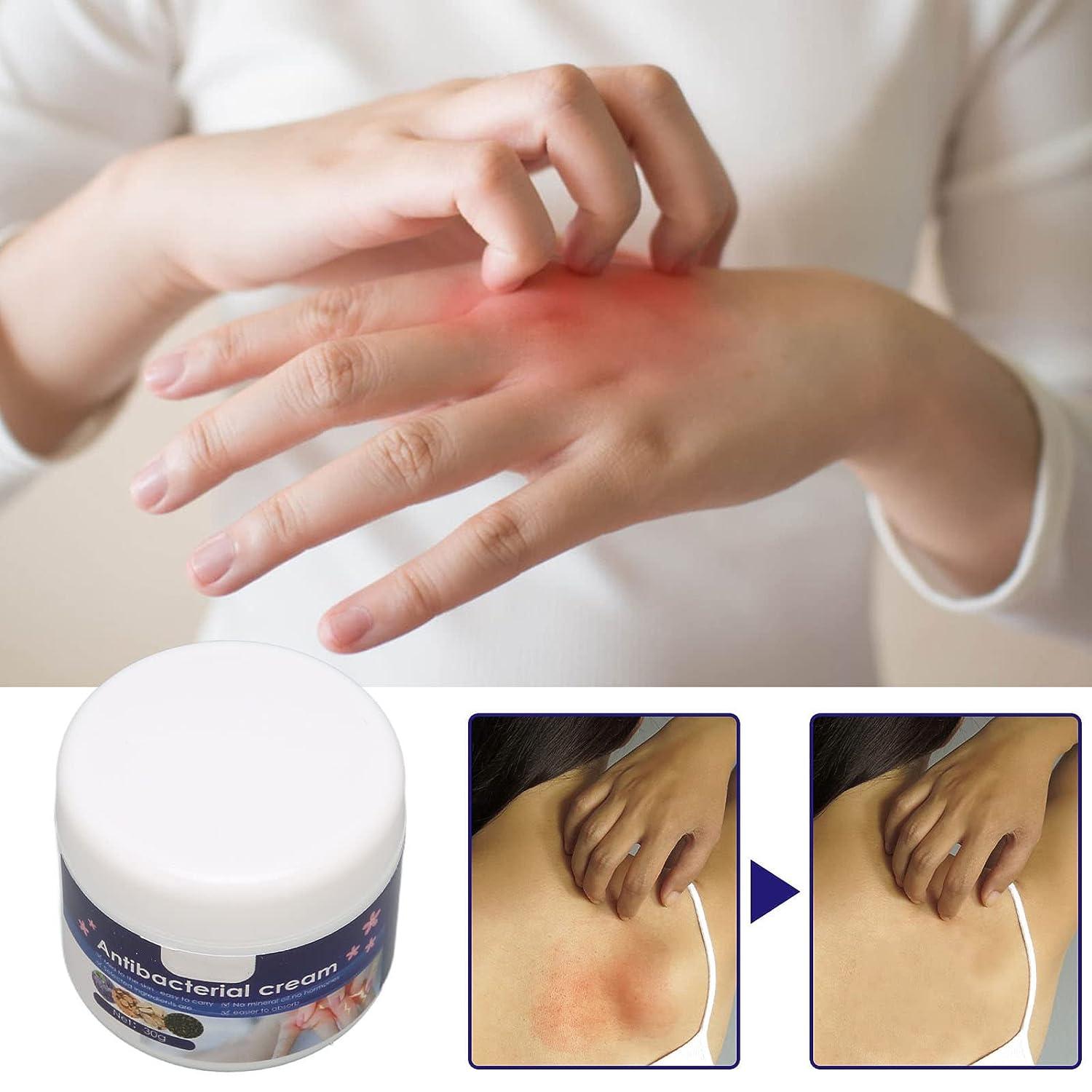 30g Anti Itch Hydrating Cream for Fast Relief of Skin Irritation and ...