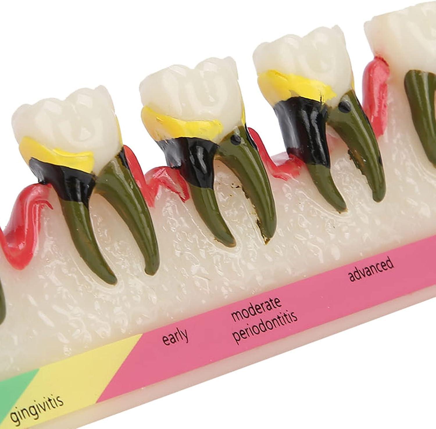 Dental Periodontitis Model | Periodontal Development Study Tool for ...