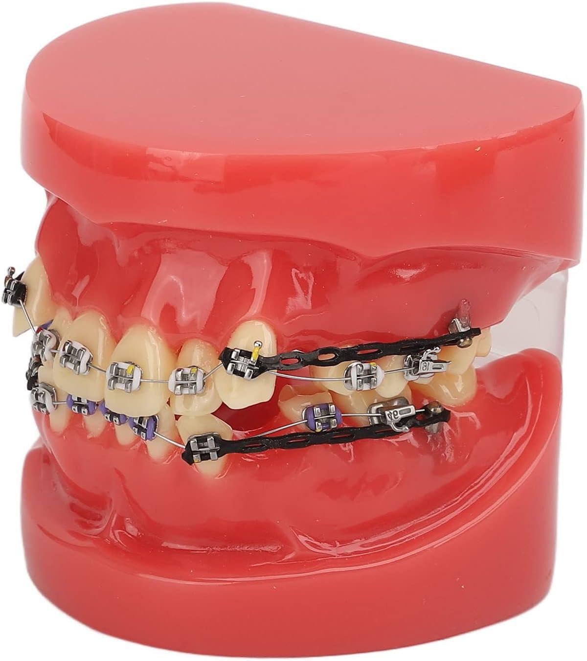 Orthodontic Bracket Model - 24 Teeth Demonstration Model with Metal ...