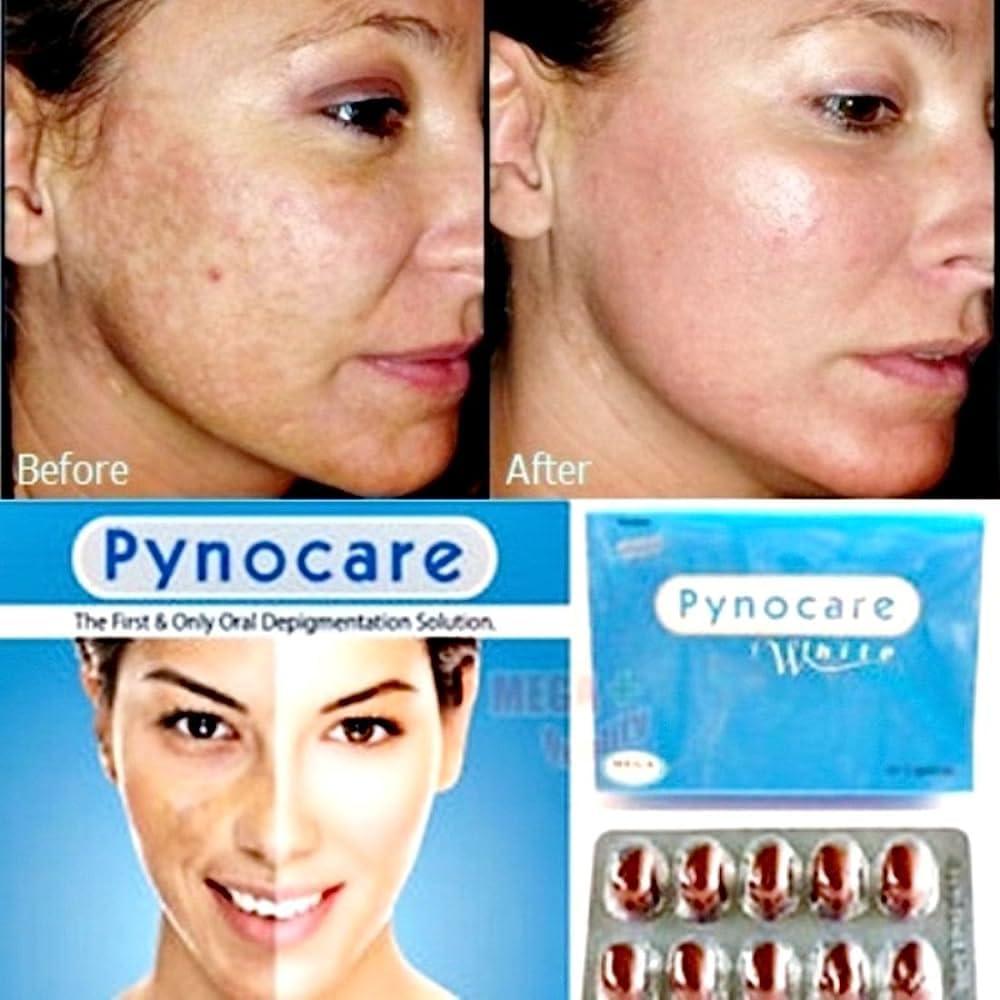 Nakarad Pynocare White Melasma Treatment - 20 Capsules | Buy Now with ...