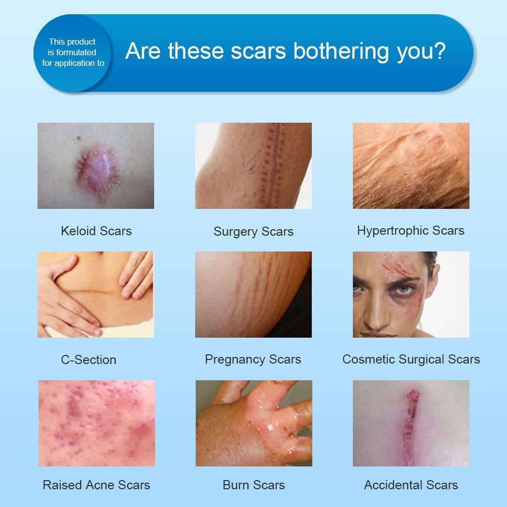 Aroamas Scar Silicone Gel 30g - Soften & Flatten Surgical Scars ...