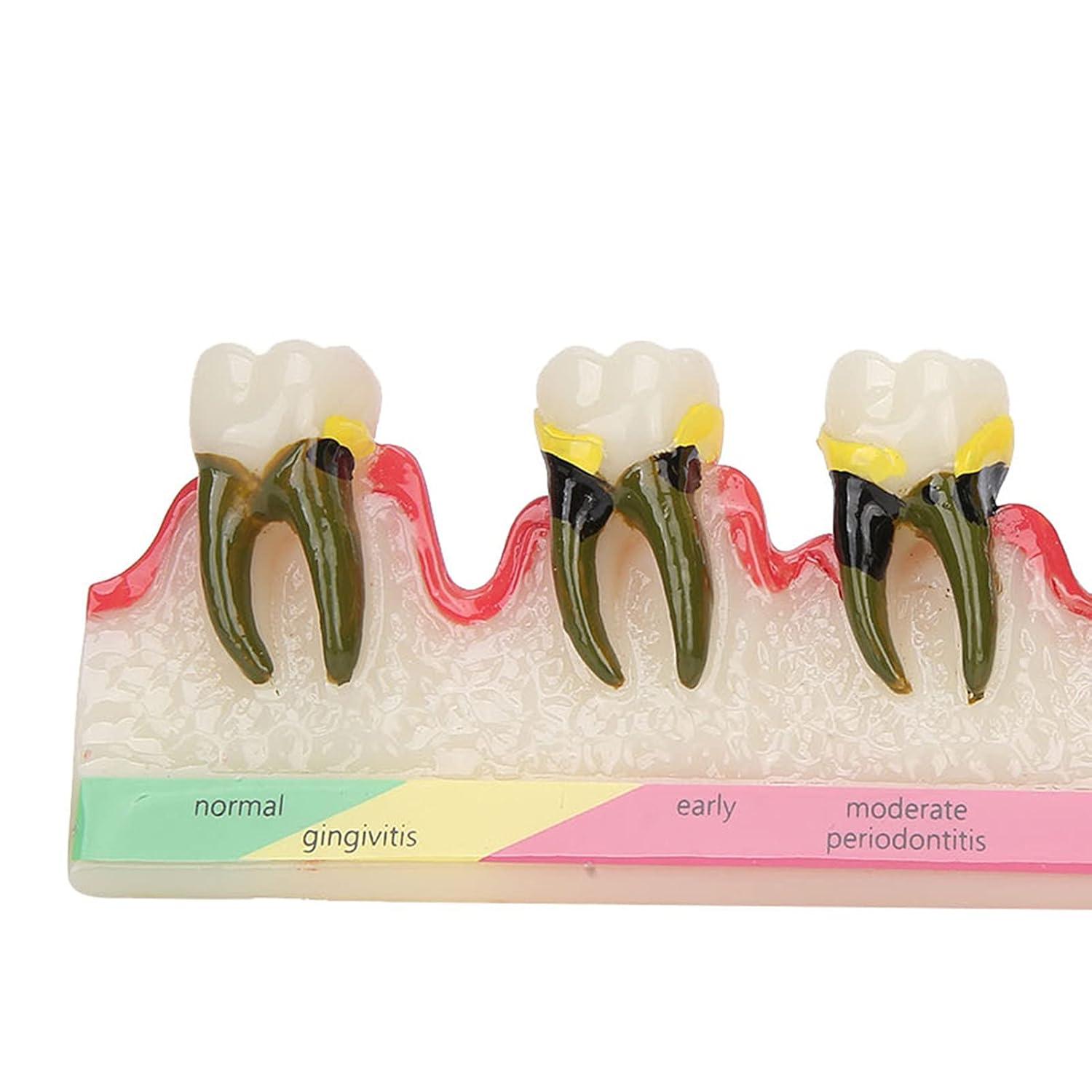 Dental Periodontal Disease Model Tooth Disease Study Teaching Model for ...