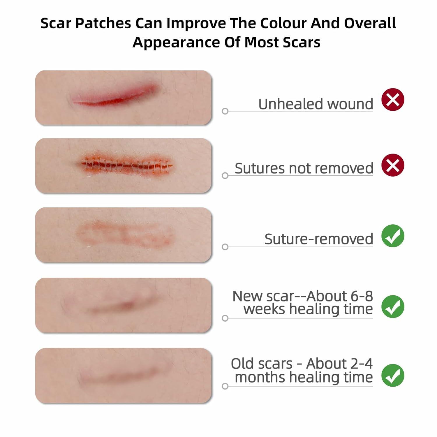 Silicone Scar Sheet & Tape for Effective Keloid Treatment | 1.6 x 120 ...