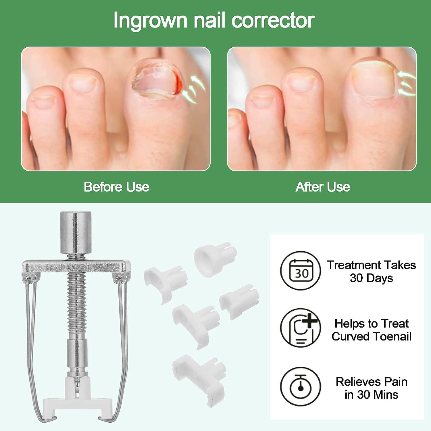 Ingrown Toenail Treatment Kit | Toe Nail Correction Tool Set with ...