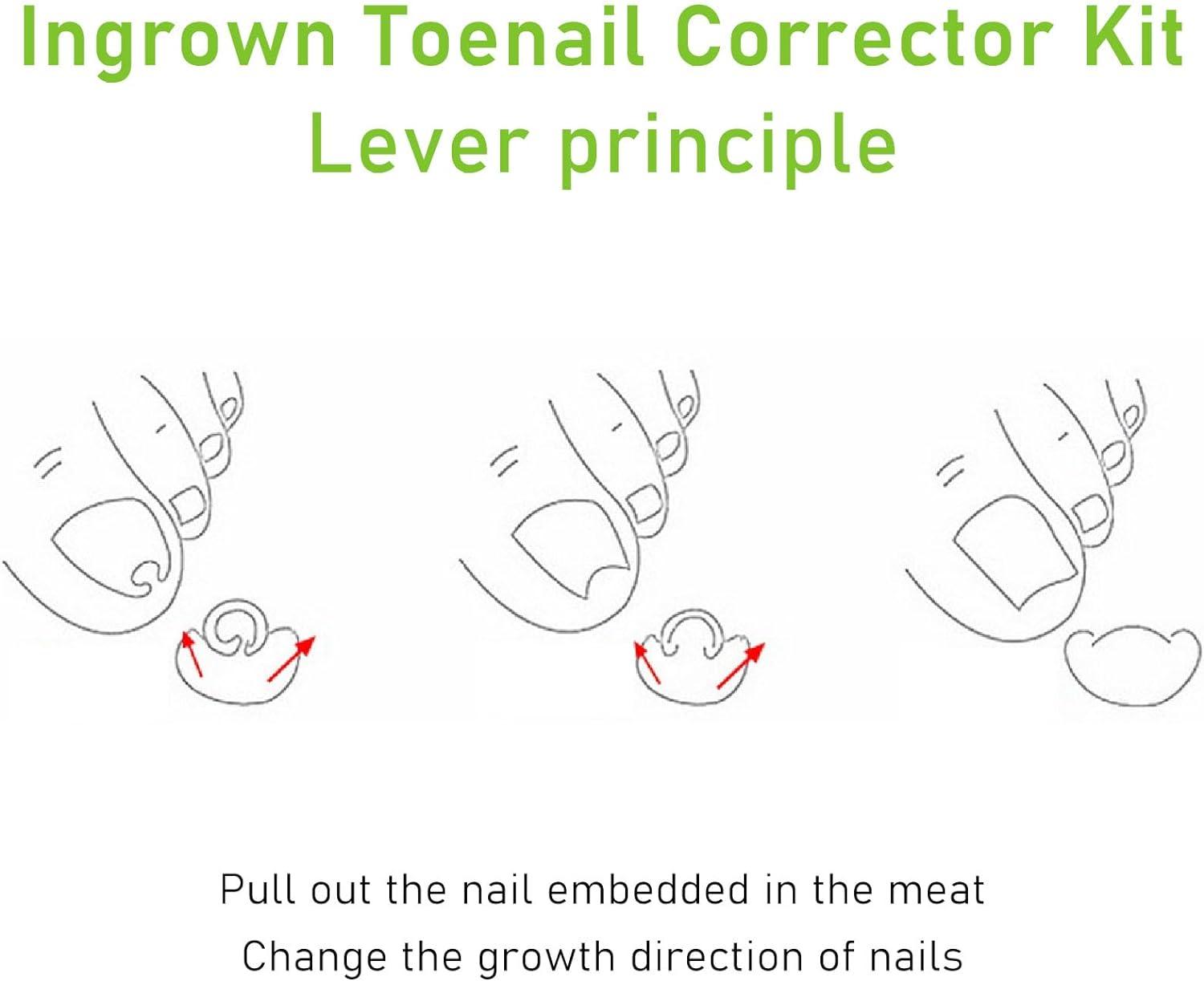 5PCS Ingrown Toenail Lifter Tool Set Ingrown Toenail Corrector Reduce ...