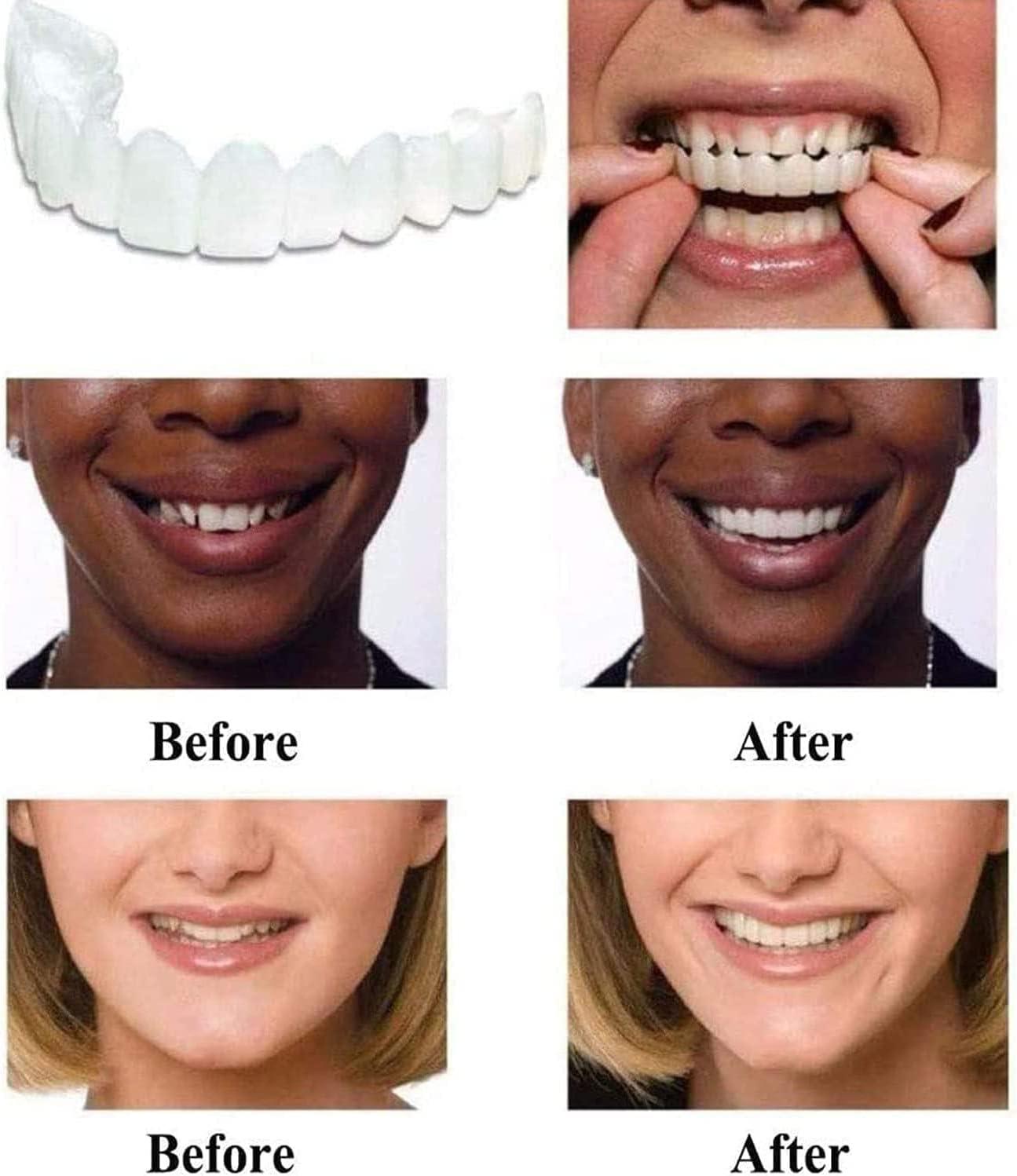 Flipped Warm Teeth Veneers Set - 2 Pairs for Immediate Cosmetic ...