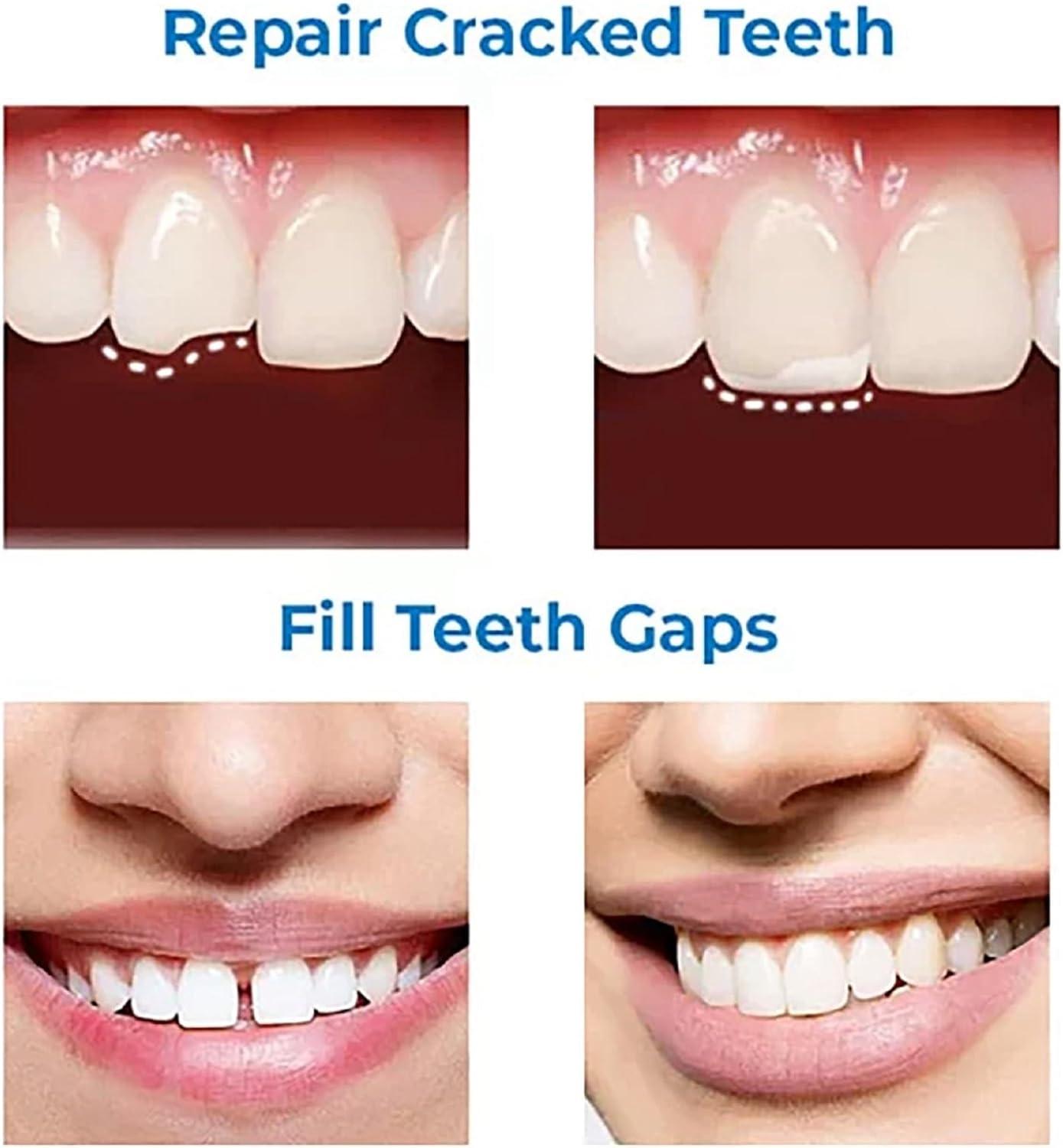 Temporary Tooth Filling Repair Kit - Dental Tooth Filler for Missing or ...