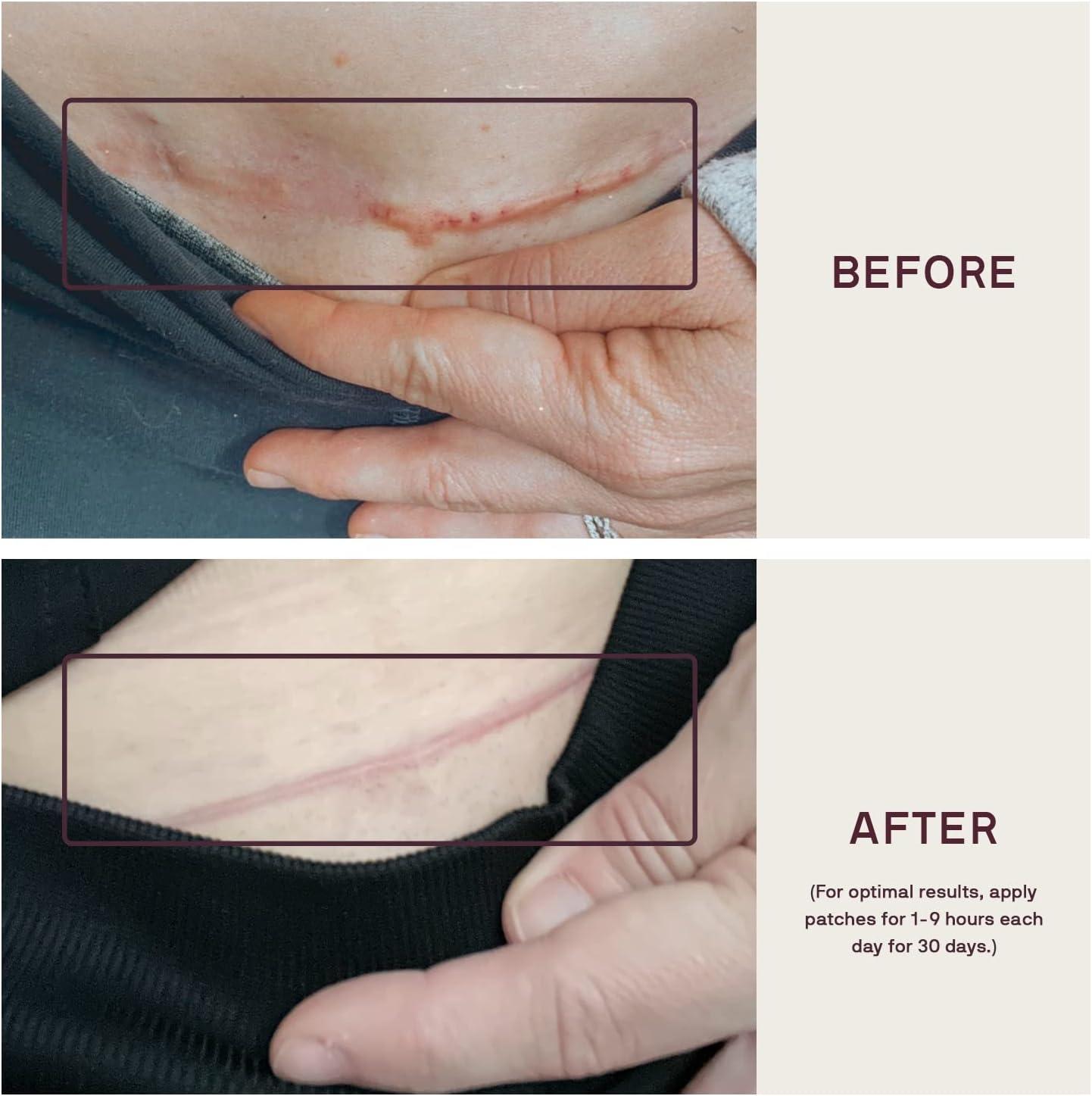 Dermaclara Siliconefusion C-Section Kit - Reusable Silicone Scar Patch ...