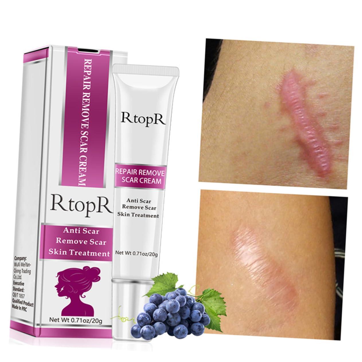 Anneome Scar Cream - Scar Eraser for Face & Body | Skin Repair ...