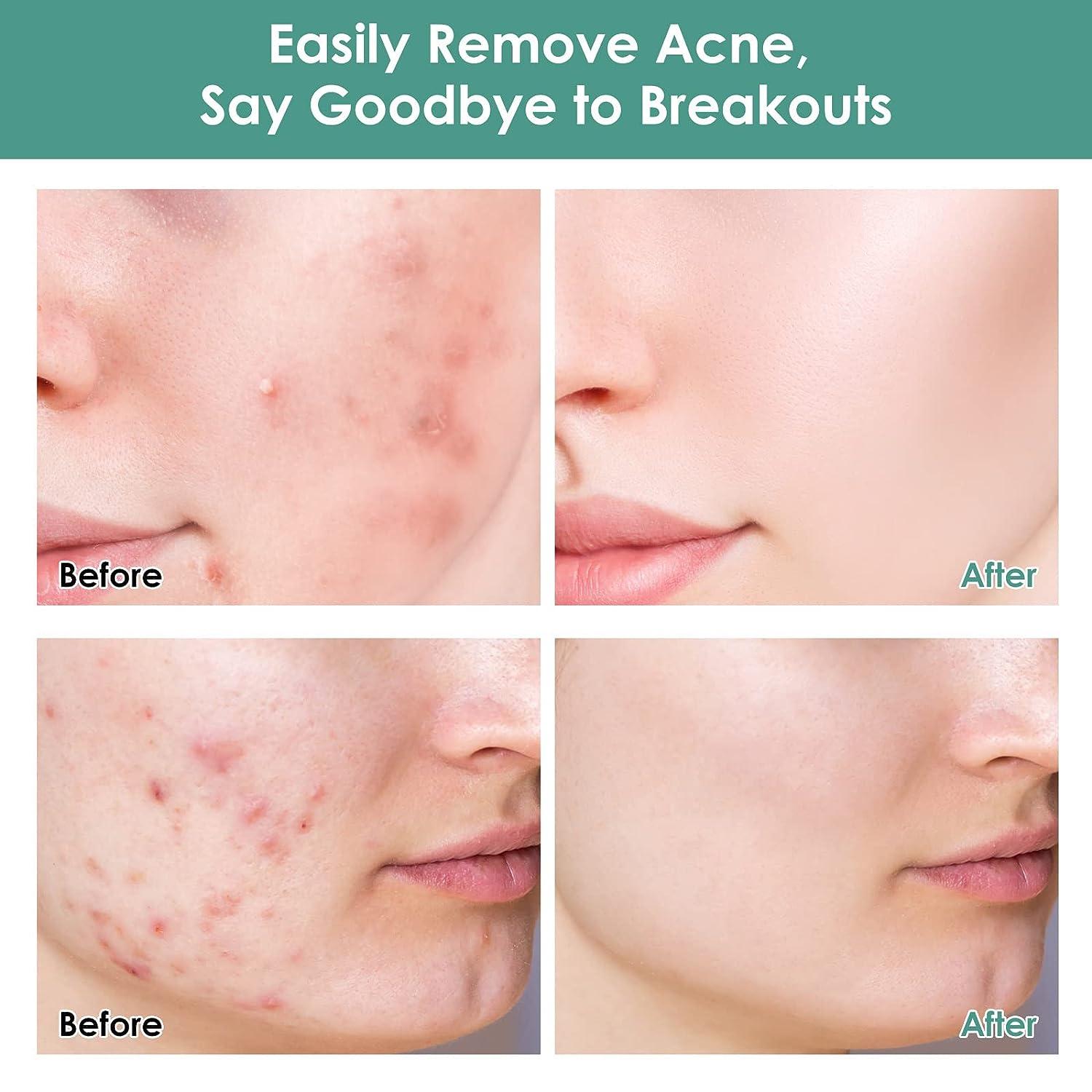Cystic Acne Treatment Acne Treatment Acne Cream for Face Provides the ...