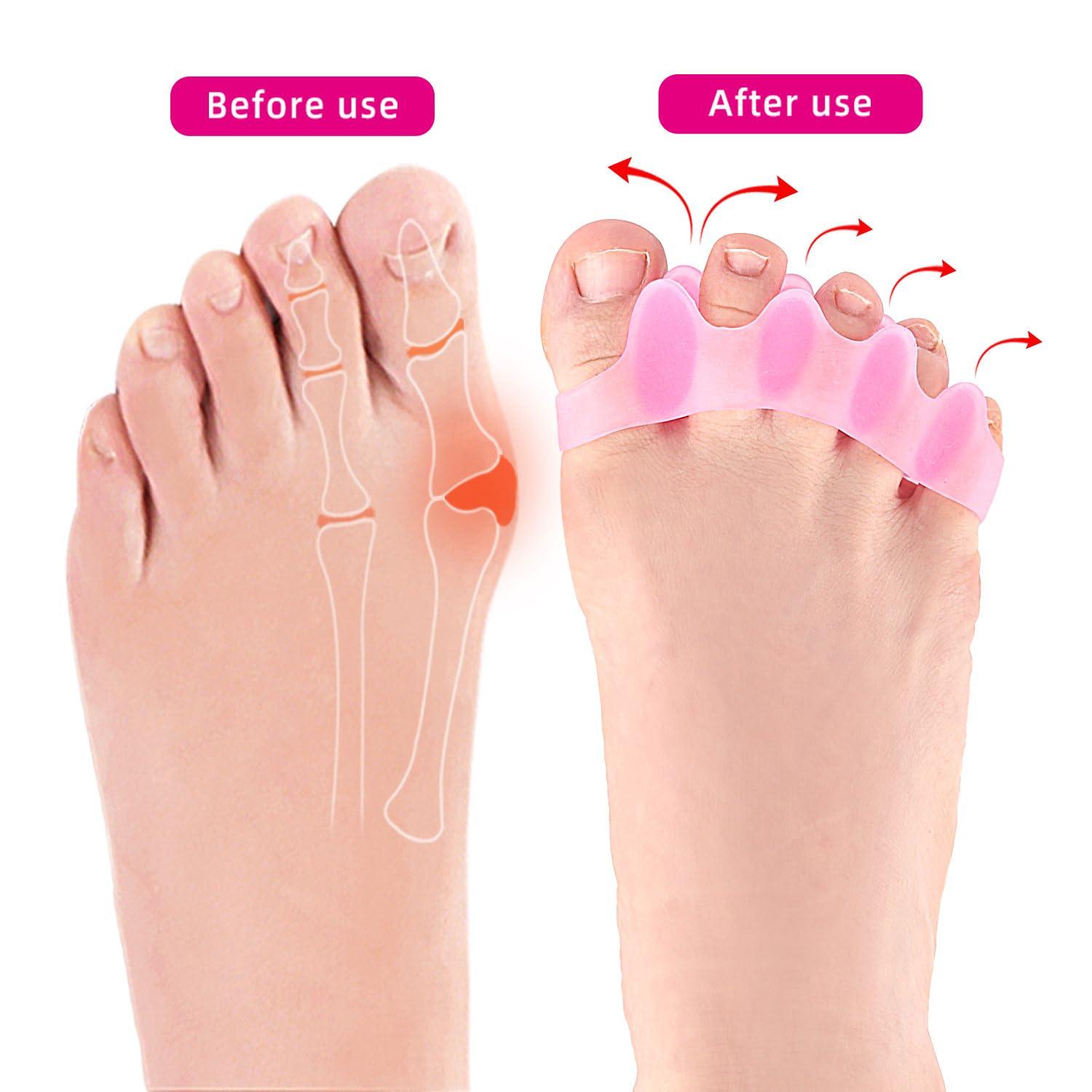 2 Pairs Toe Separators for Foot Pain Relief - Correct Bunions and ...