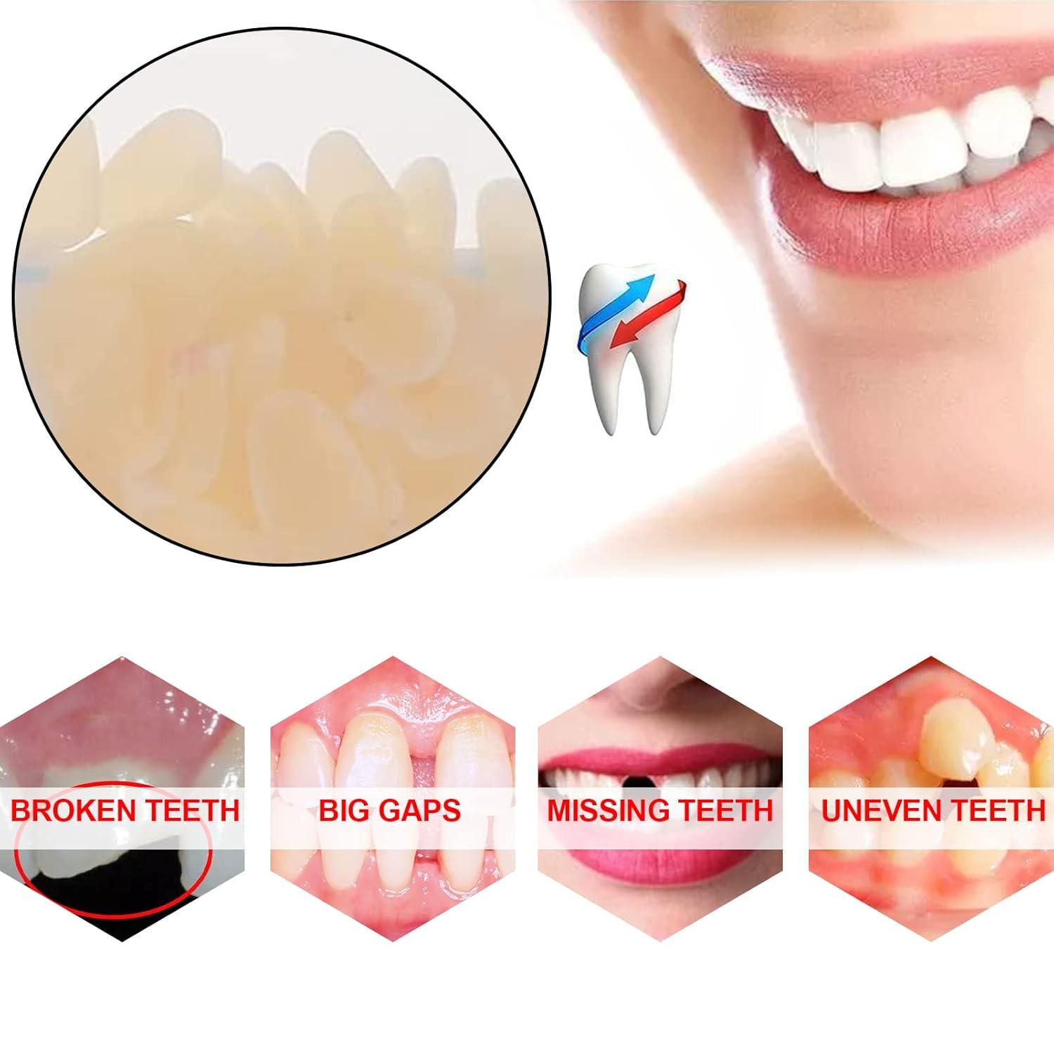 100pcs Temporary Crowns of Tooth Crowns 2 Types of Strong Temporary ...