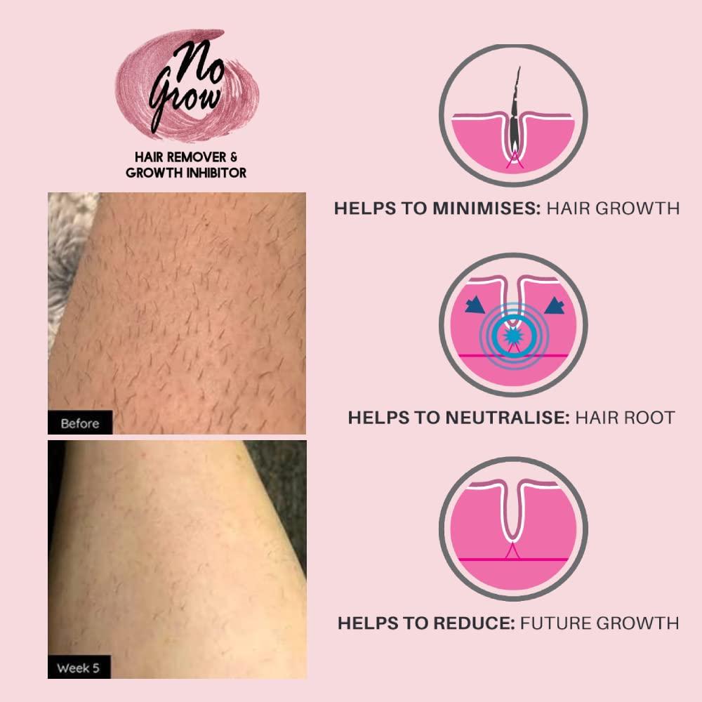 NoGrow Permanent Hair Inhibitor & Removal (Female Facial) | Laser Hair ...