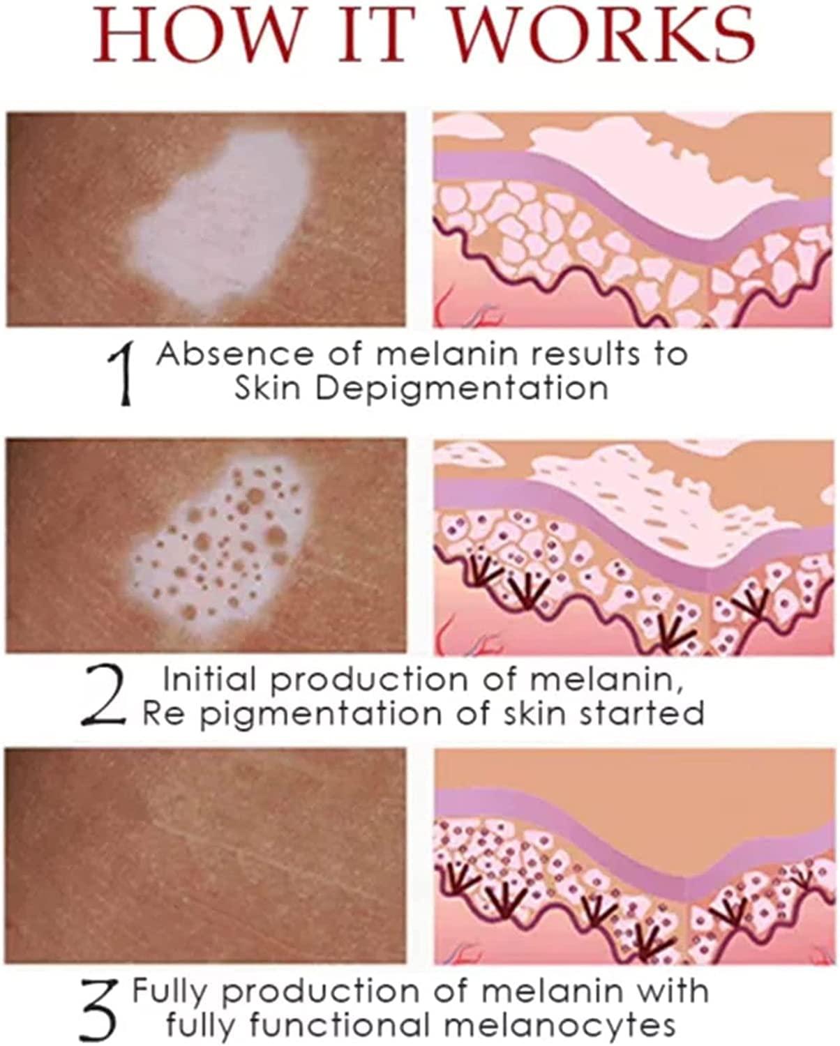 Vitiligo Treatment Spray - Skin Pigmentation Care & White Spot ...
