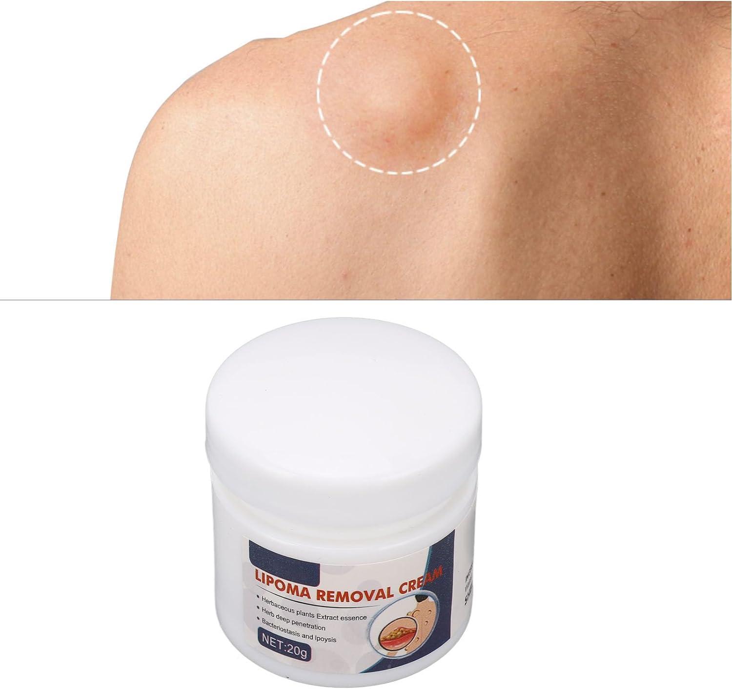 Lipoma Removal Cream 0.7oz | Anti-Inflammatory Cellulite Treatment for ...