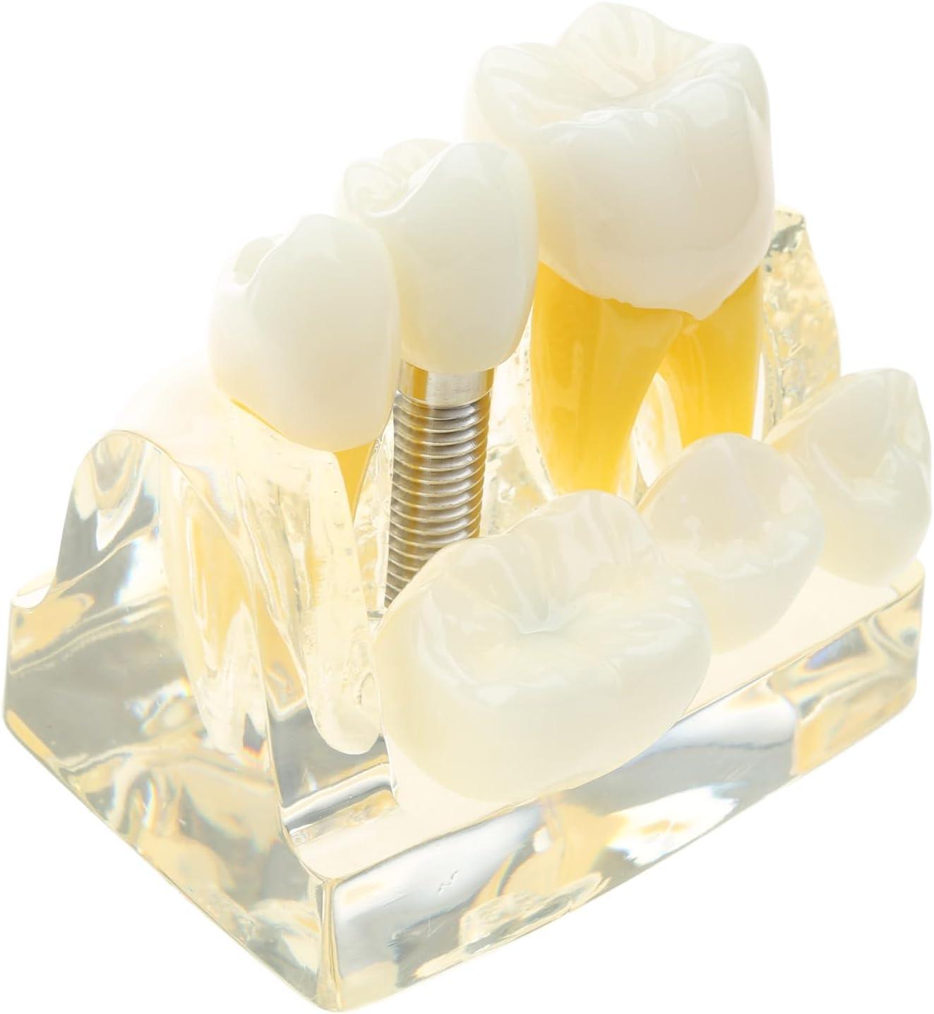 Implant Model Removable Bridge - Educational Teeth Model for Dental ...