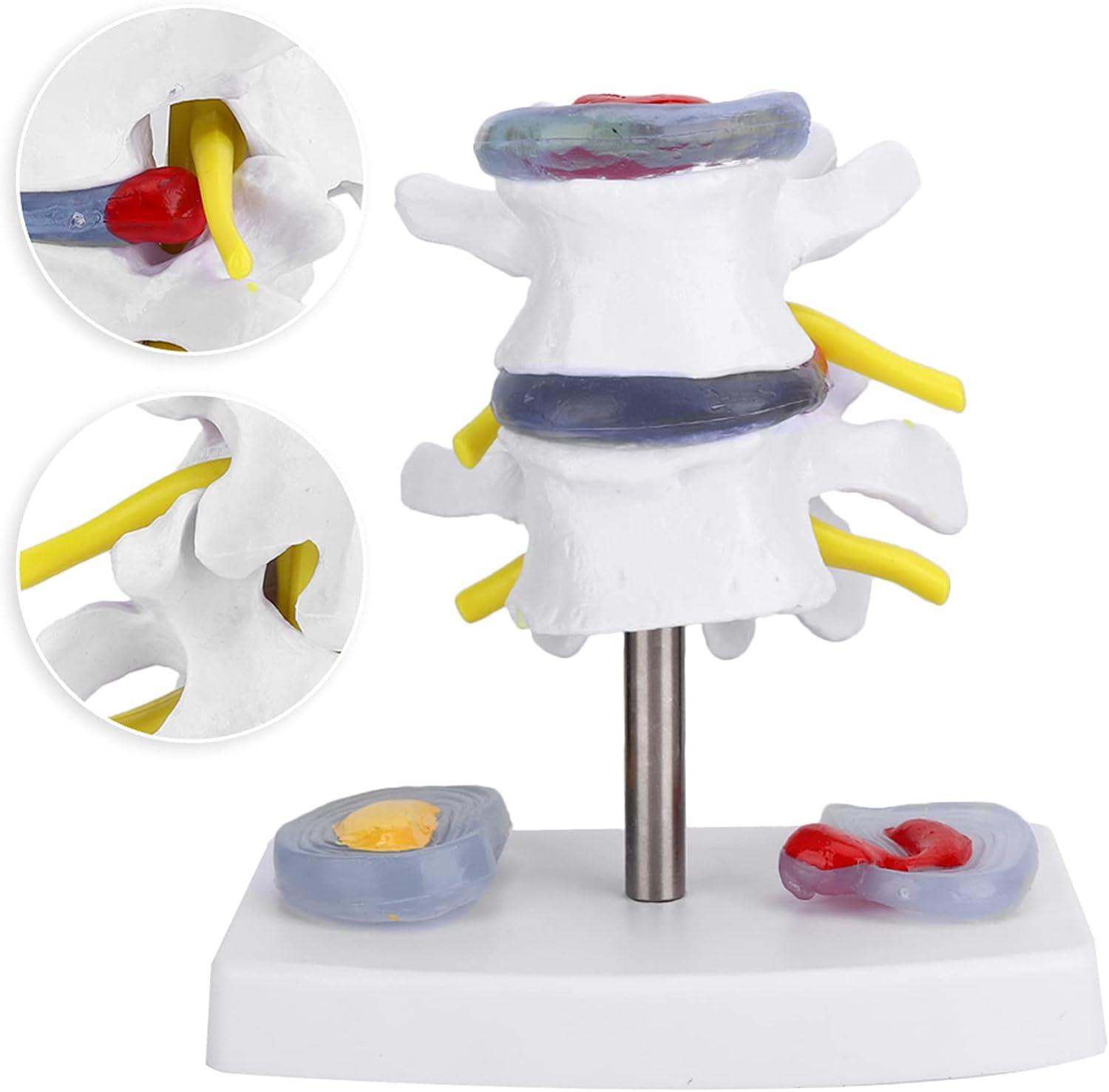 Anatomical Lumbar Intervertebral Disc Model - Spine Demonstration for ...