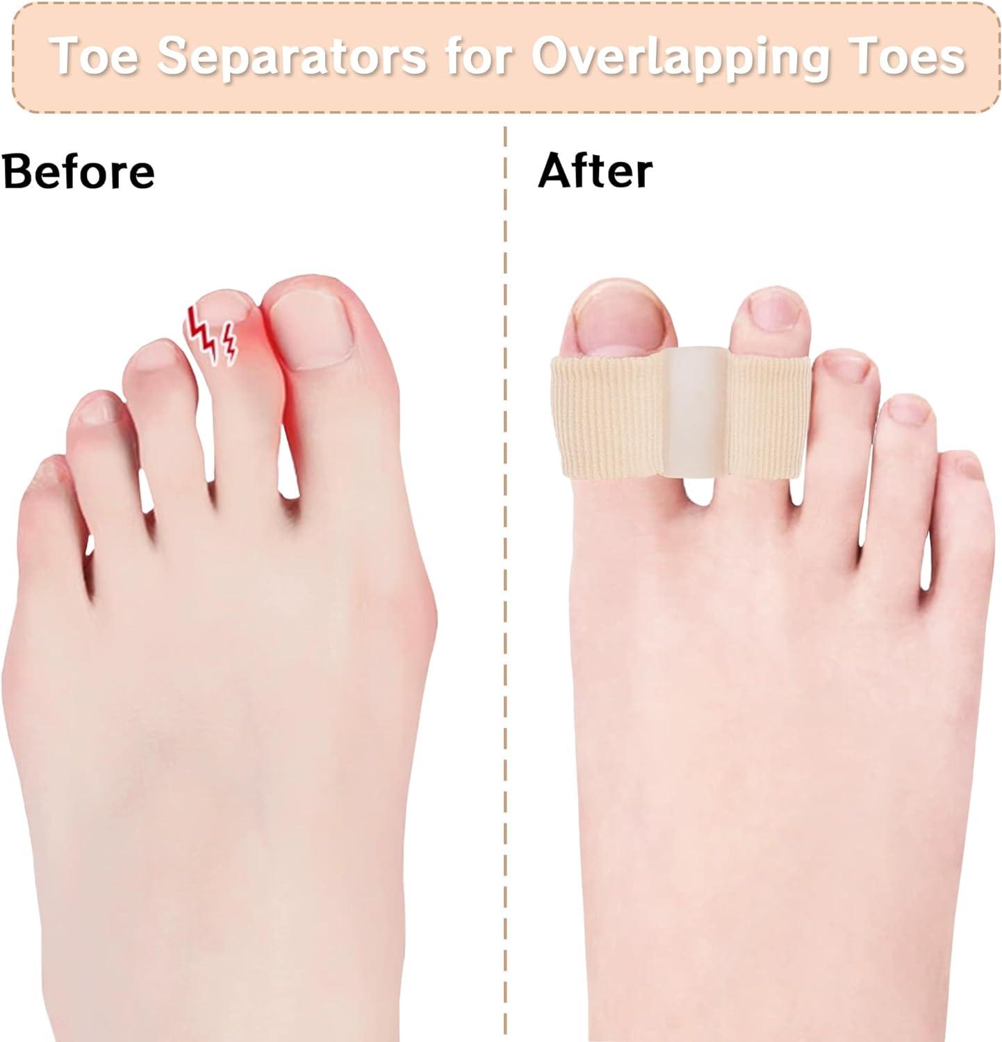 12 Pack Toe Spacers for Overlapping Toes - Toe Separators for Bunion ...