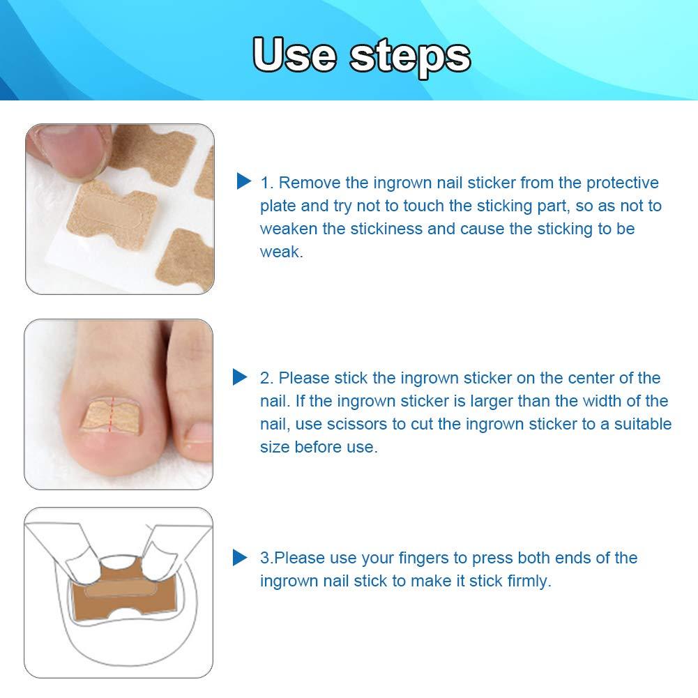 Ingrown Toenail Corrector Patch - Painless Toe Nail Correction Strips ...