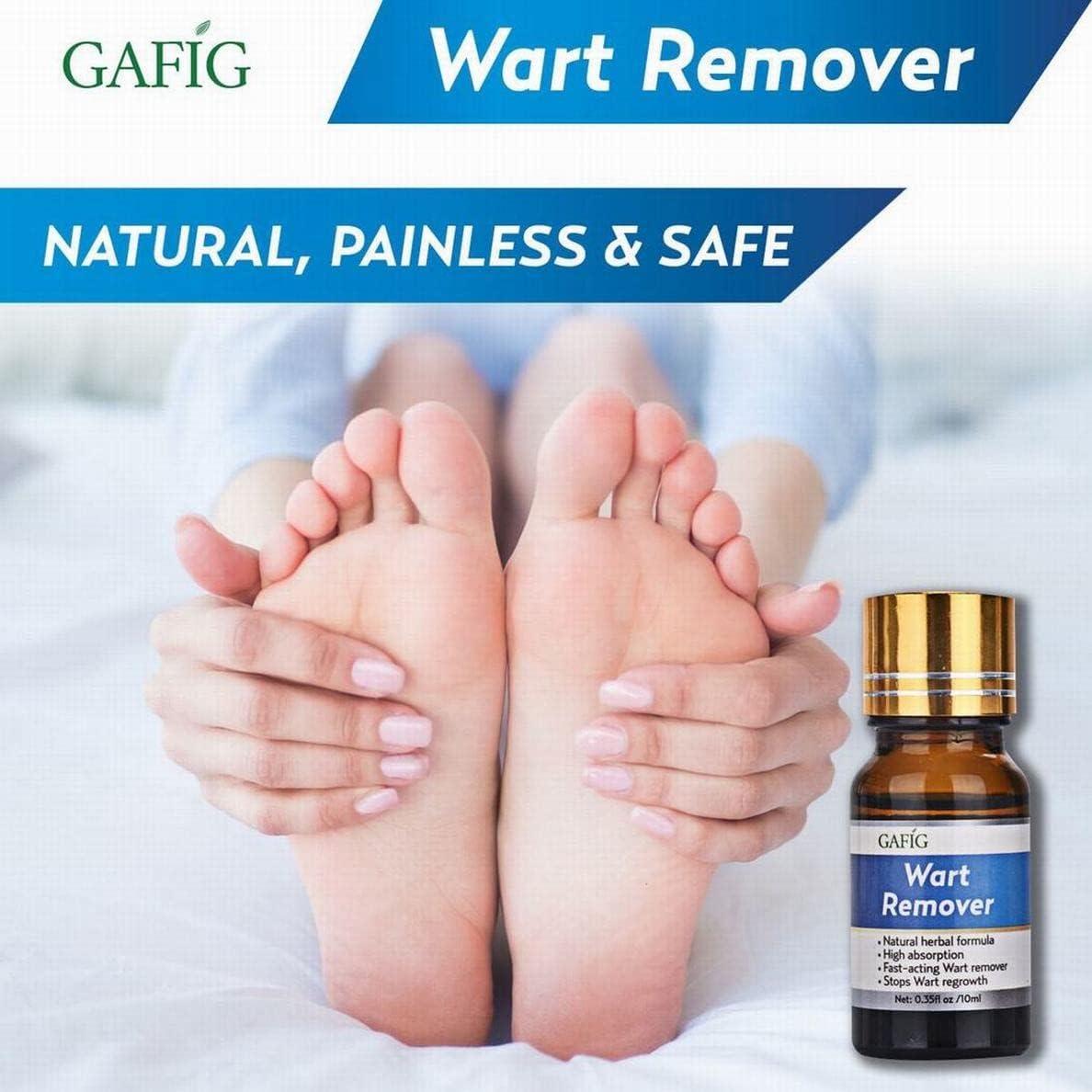 Gafig Wart Remover - Painlessly Removes Common Hand and Plantar Warts ...