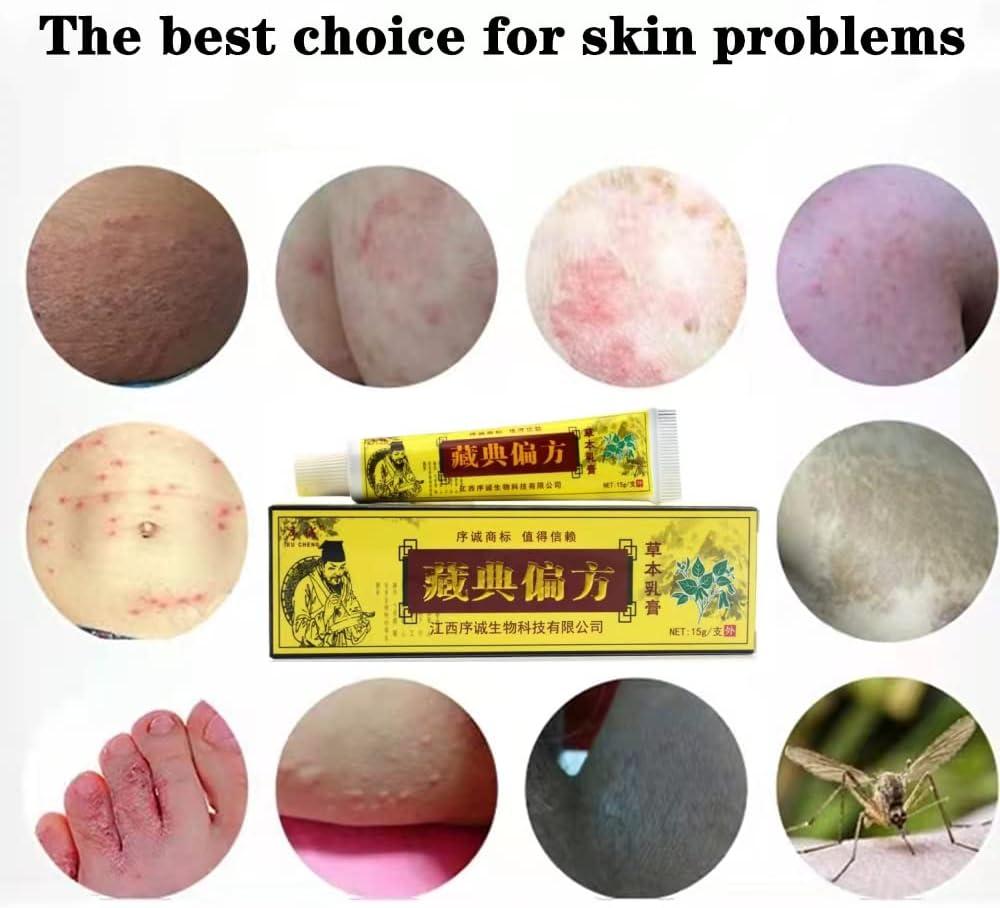 1pcs Natural Chinese Herbal Eczema Psoriasis Cream Dermatitis Pruritus ...