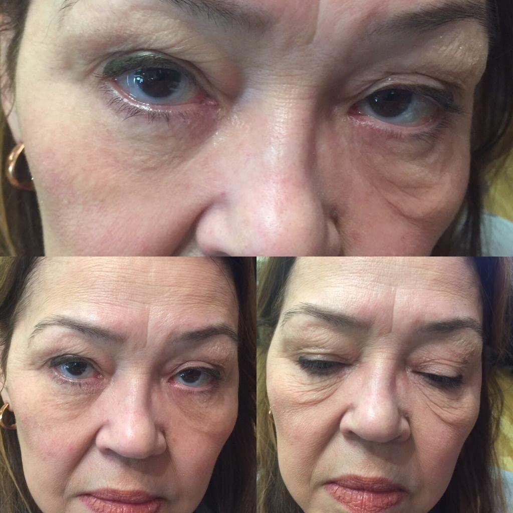 Dynamic Innovation 60 Second Instant Eye Lift - Fast and Effective ...
