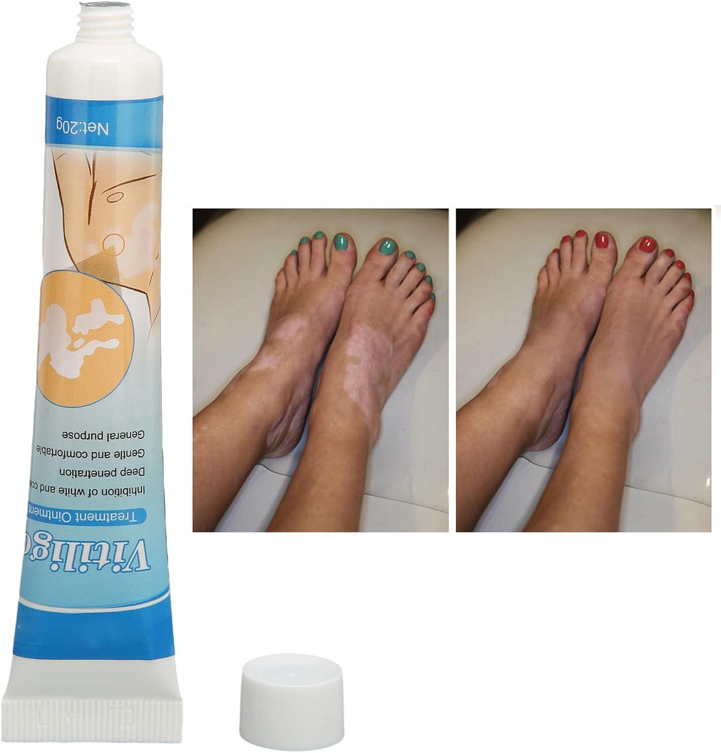 Herbal Vitiligo Cream 0.7oz - Skin Pigmentation Treatment Ointment ...