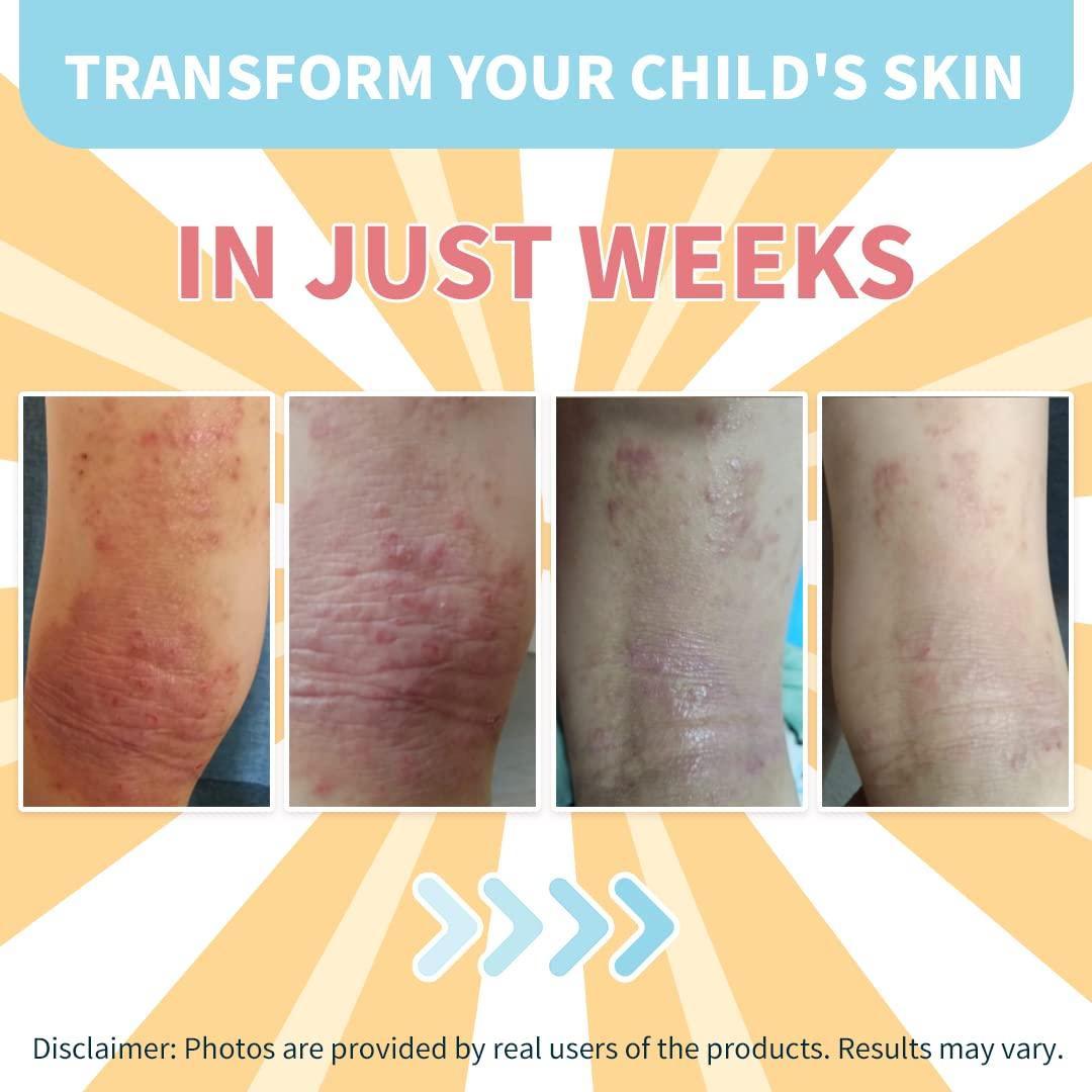 Cubed Eczema Body Butter for Kids with Honey and Oatmeal - Soothing Anti-Itch Cream for Dry ...