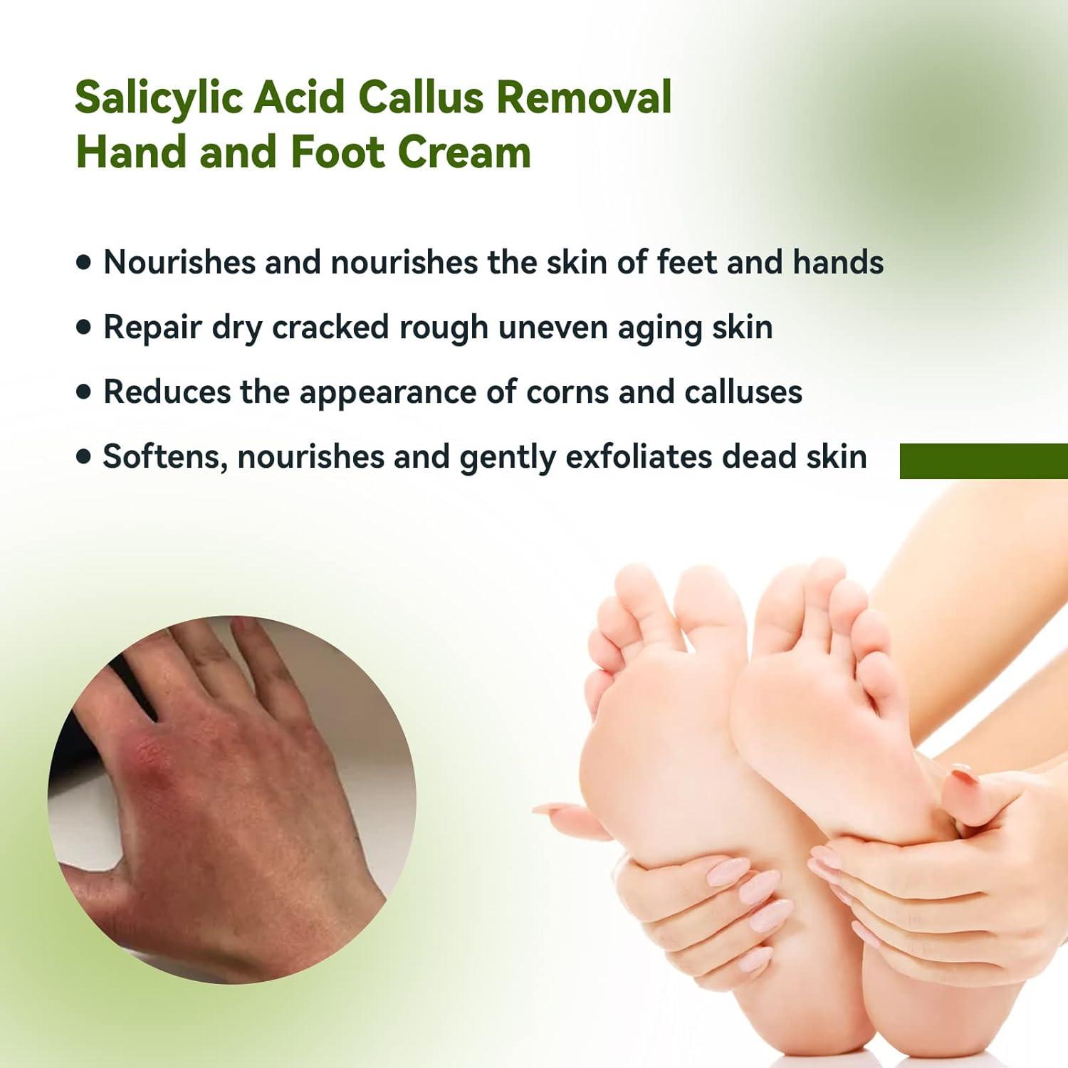 Maximum Strength 42% Urea Foot Cream Callus Remover for Dry, Hard Skin ...