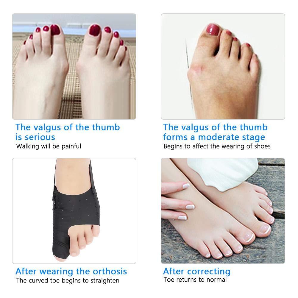 Hallux Valgus Corrector & Bunion Relief Splint with Gel Separator ...