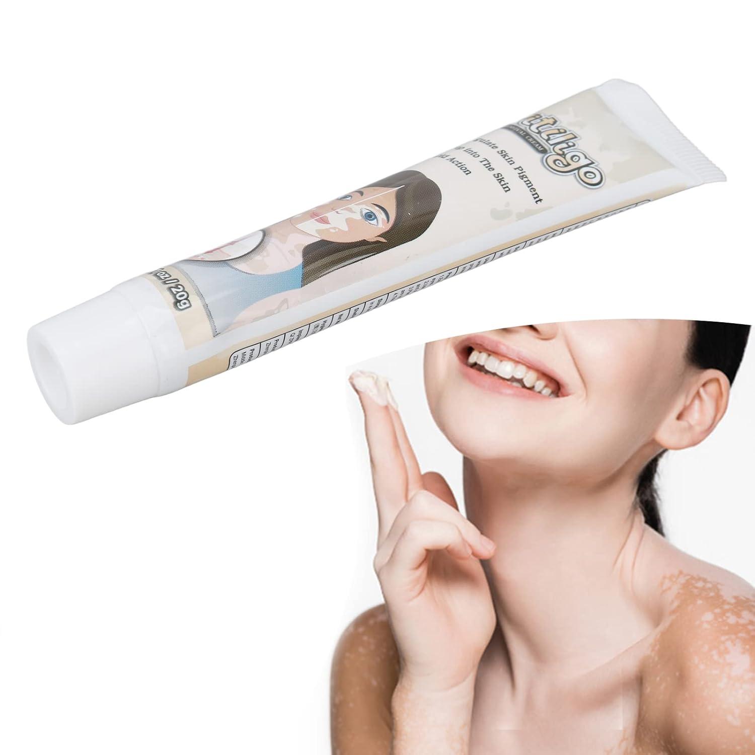 Professional Vitiligo Cream with Herbal Extract for Skin Pigmentation ...