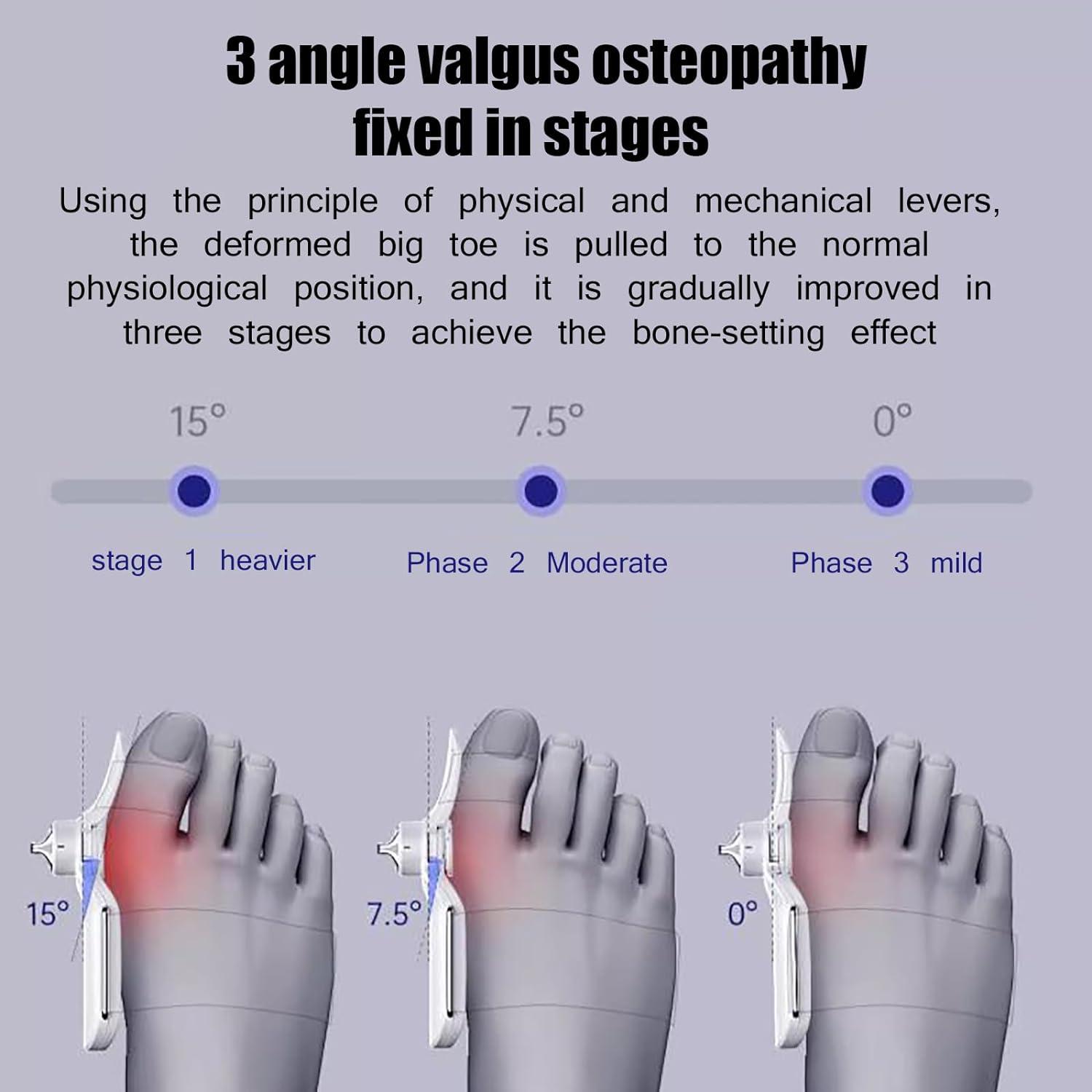 Thumb Valgus Corrector Bunion Device - Adjustable Tightness for Bunion ...