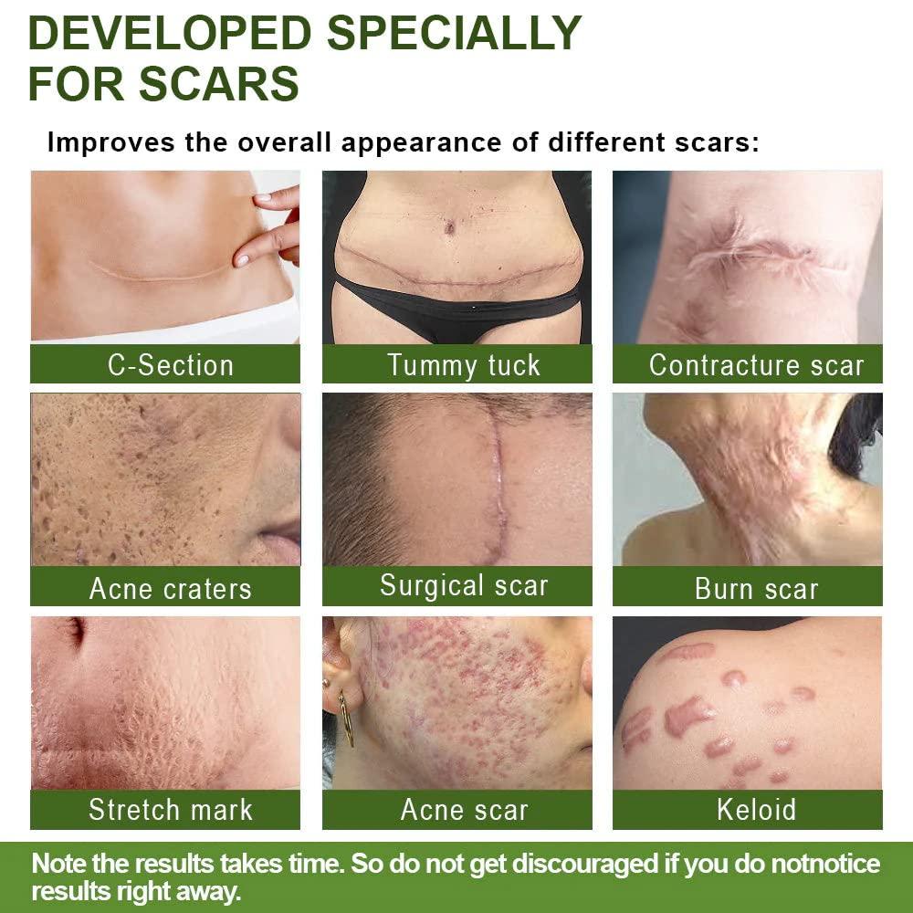 Goopgen Advanced Scar Repair Serum - Medical Grade Treatment for All ...