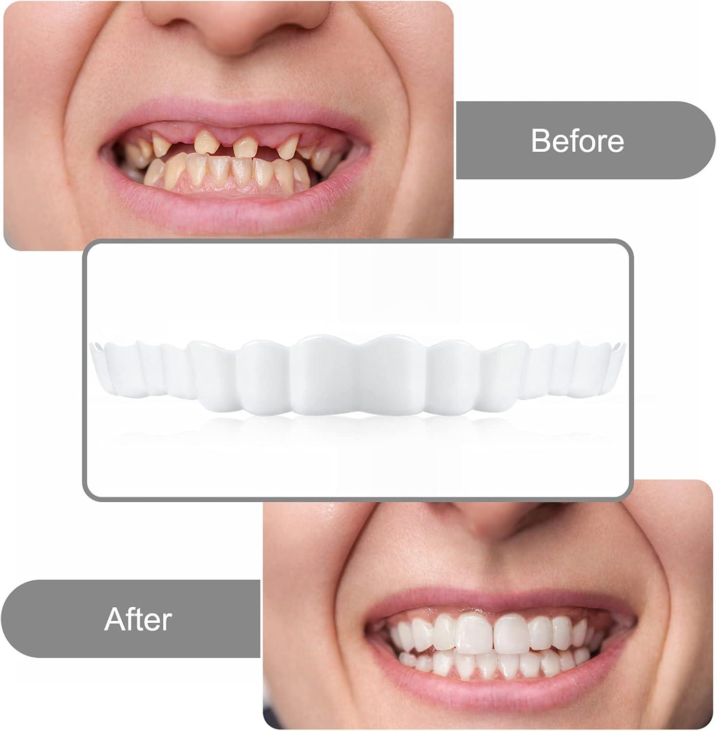 Buy Immediate Veneer Prostheses | Fake Teeth for a Perfect Smile ...
