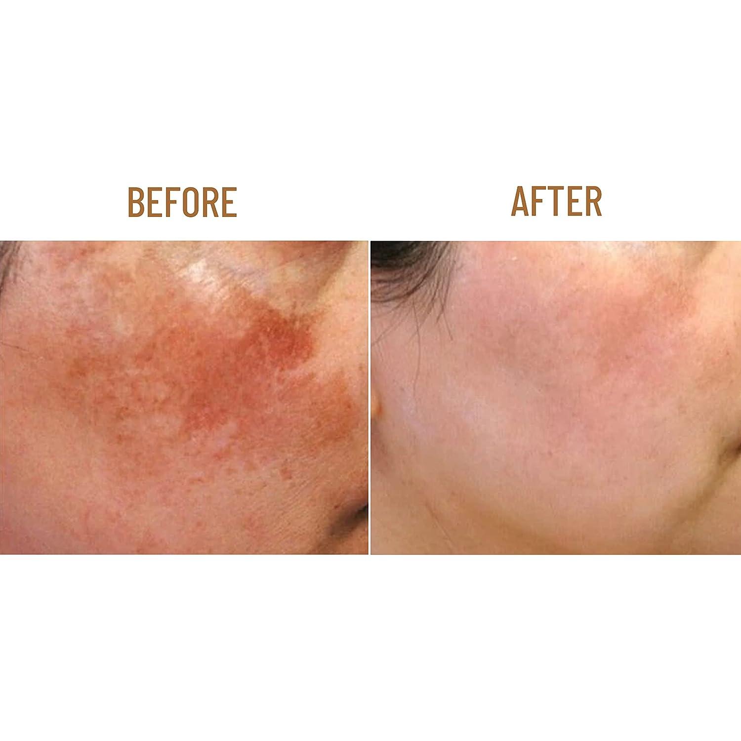 ABERA Kasumi Glowing Cream Melasma Treatment for Face Dark Spots ...