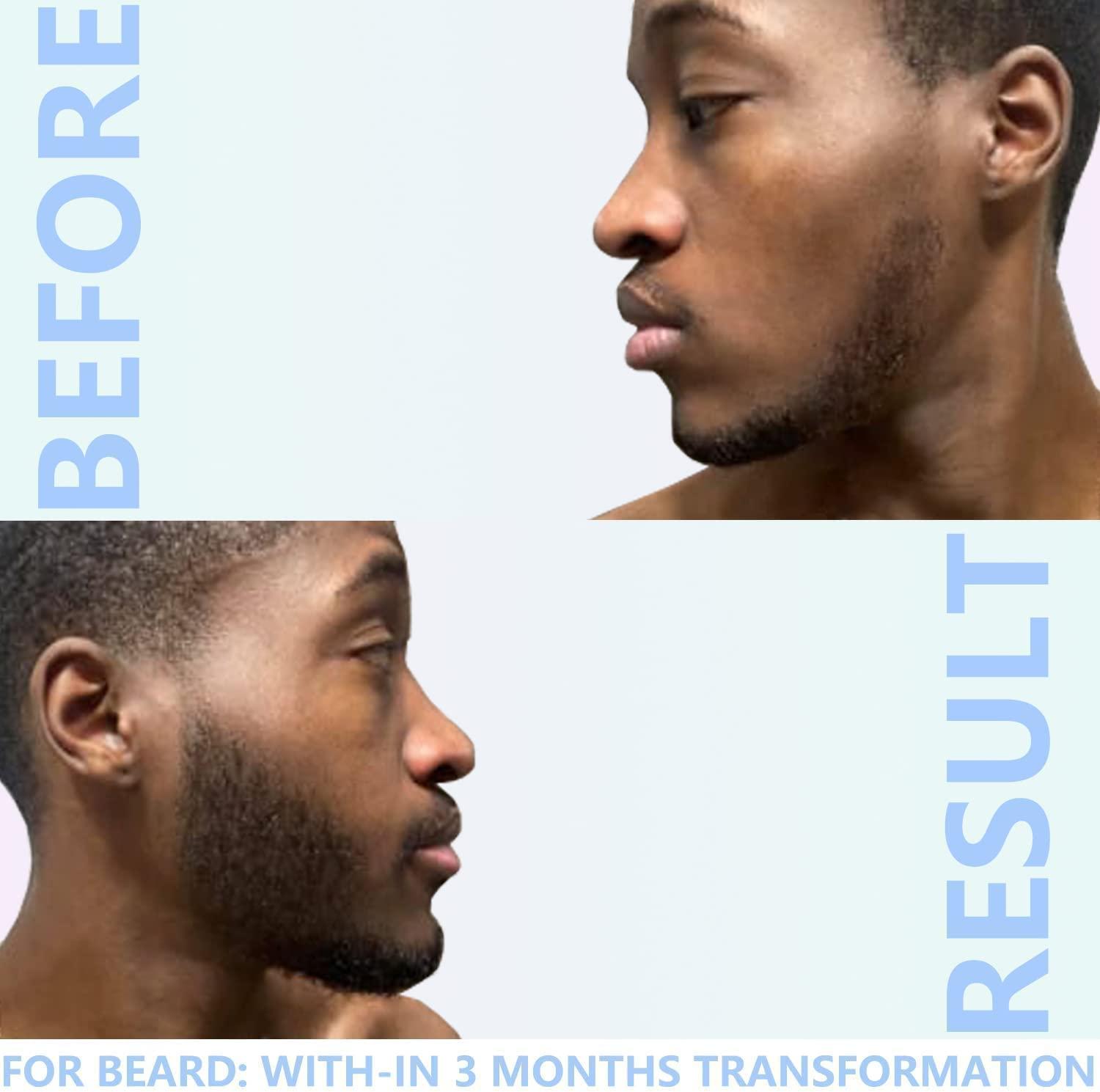 Angel Kiss Titanium Beard Derma Roller for Men - Microneedling Roller ...