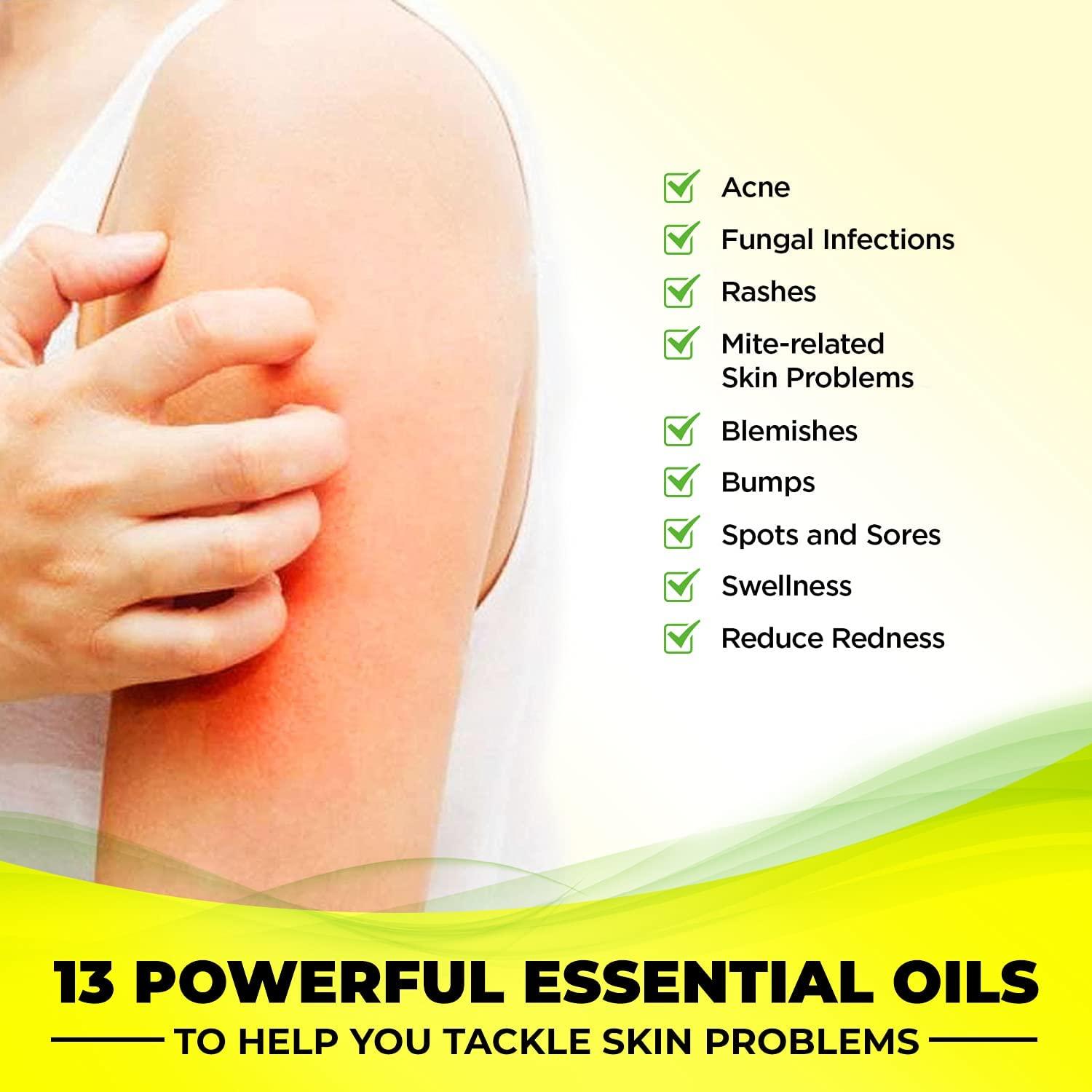 ScabiBLAST Mite Cream Lotion - Fast Relief from All Mites for Humans ...