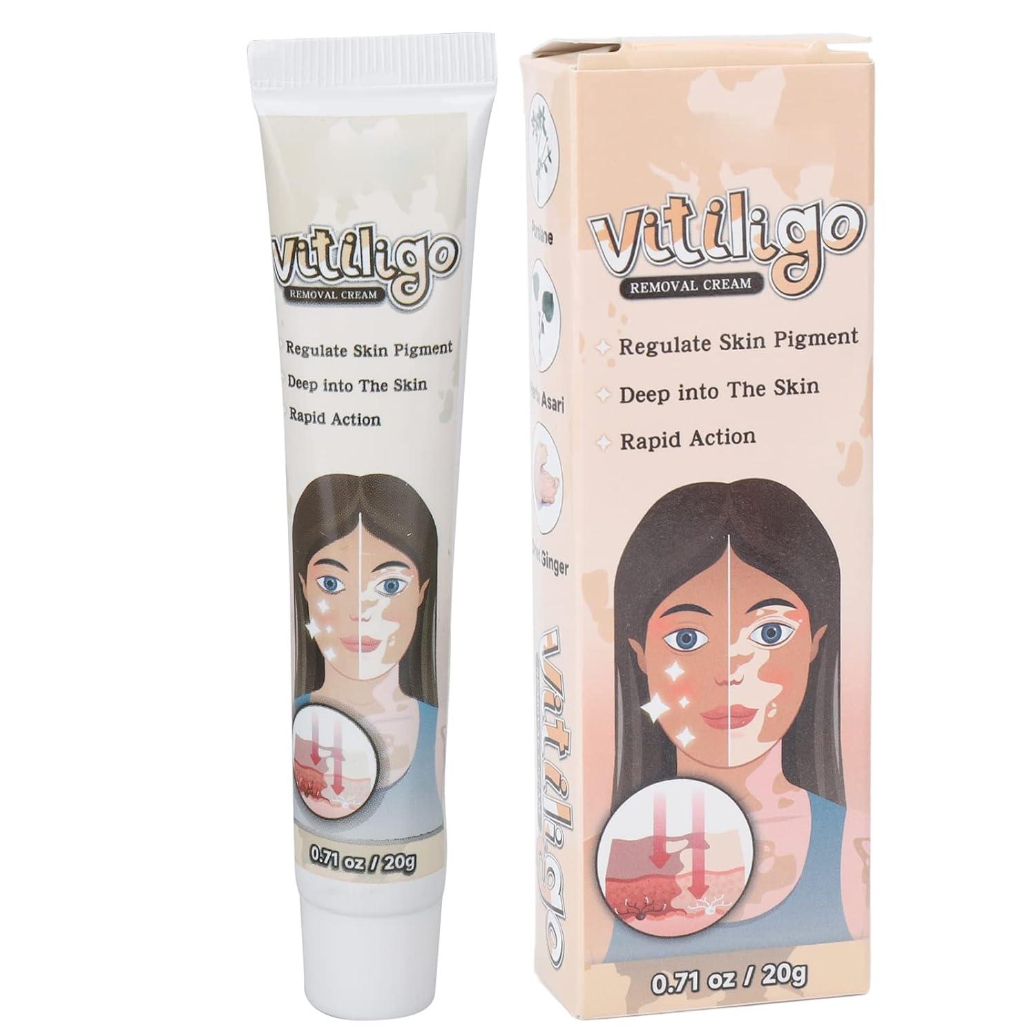Professional Vitiligo Cream with Herbal Extract for Skin Pigmentation ...