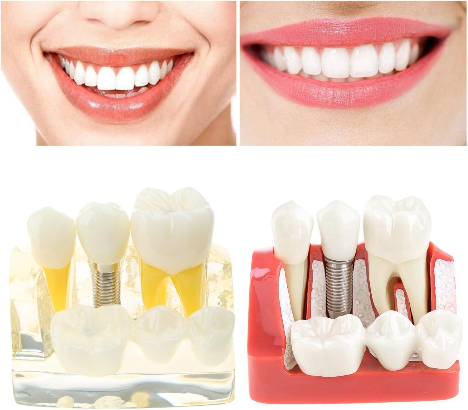 Implant Model Removable Bridge - Educational Teeth Model for Dental ...