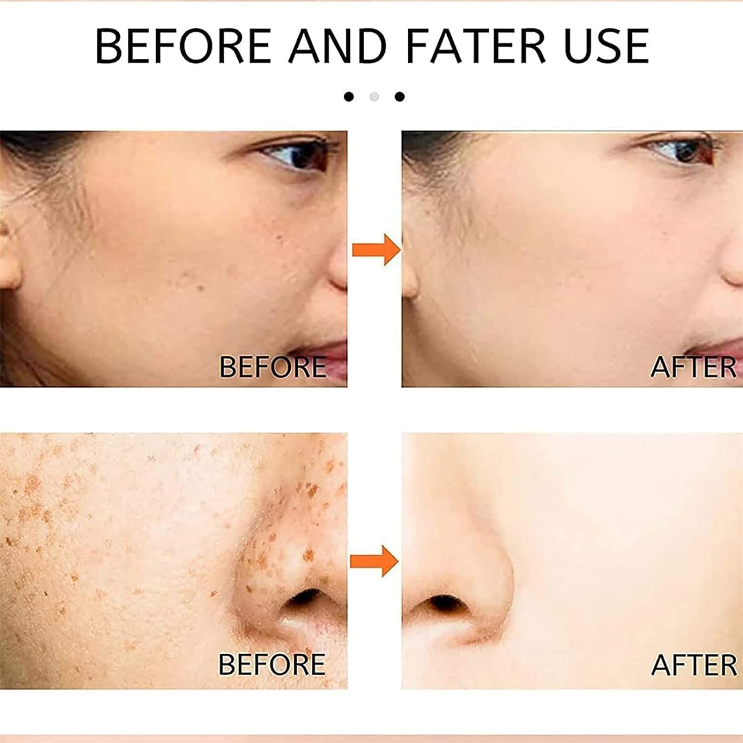 KnjoFly Japanese Melasma Cream Dr Hancy - Herbal Whitening and Dark ...