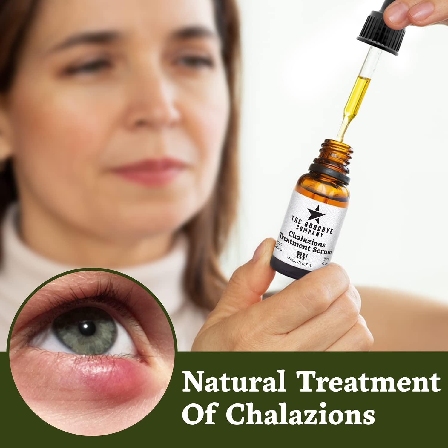 Chalazion Remover & Stye Eye Treatment - USA Made (15ml) | Buy Now with ...