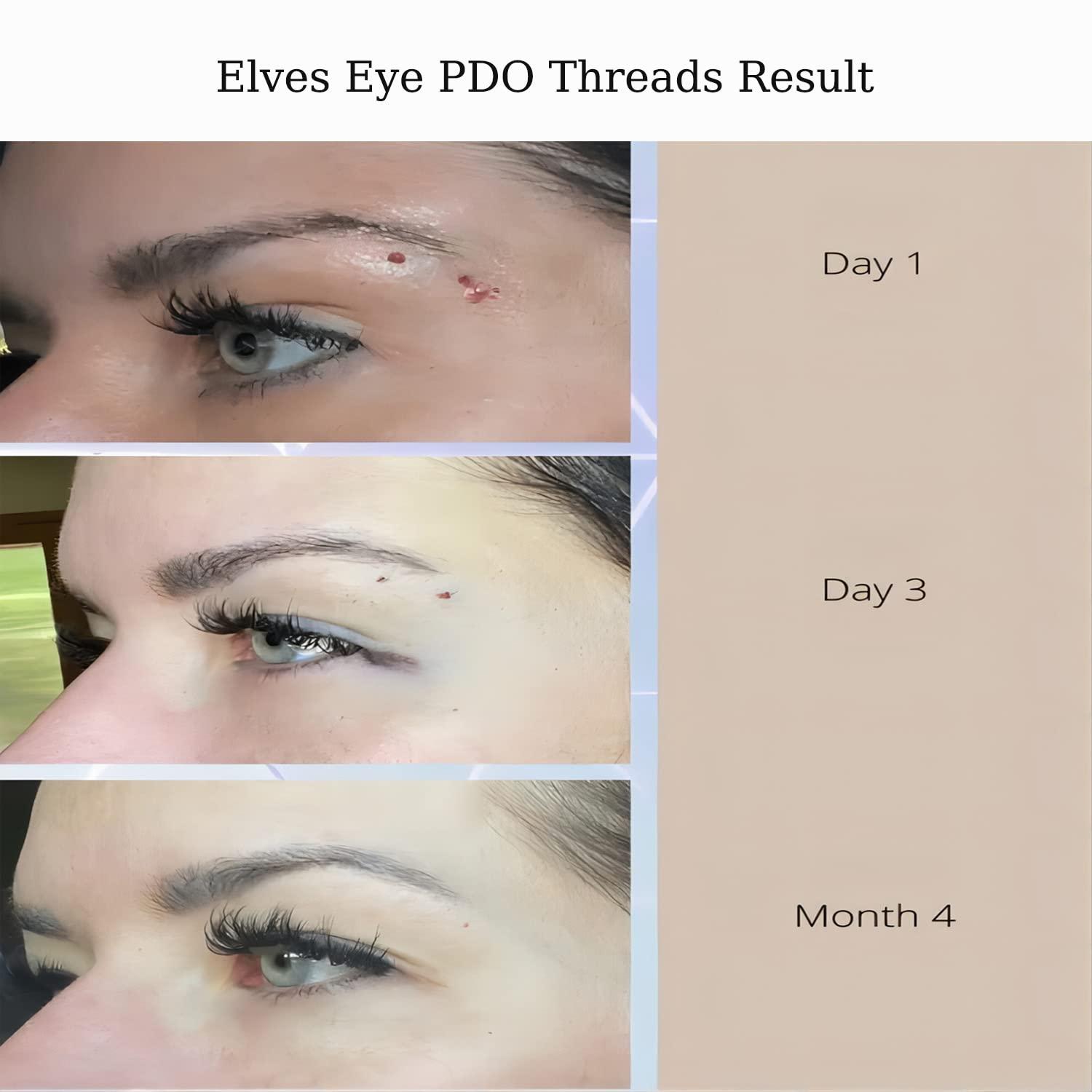 PDO Thread Lift Eye Kit - 40 Pieces 30G 25mm Bullet Blunt Threads for ...